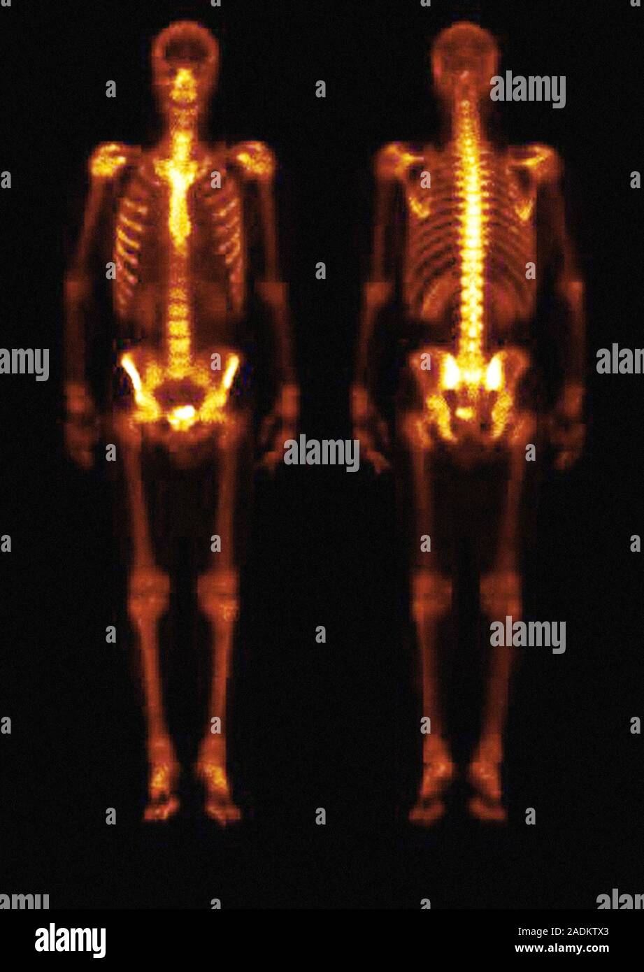 Skeleton. Coloured gamma scans of a healthy human skeleton seen from ...