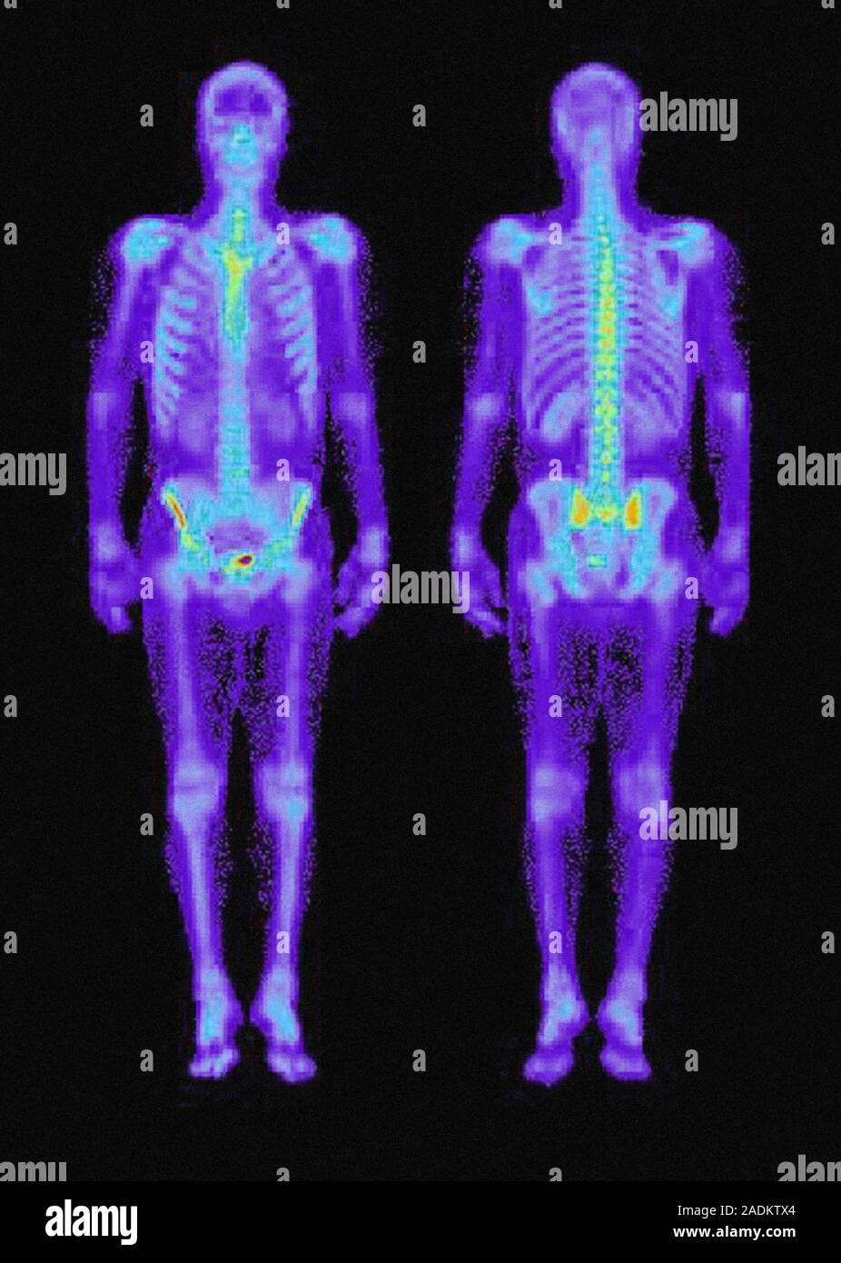 Skeleton. Coloured gamma scans of a healthy human skeleton seen from ...
