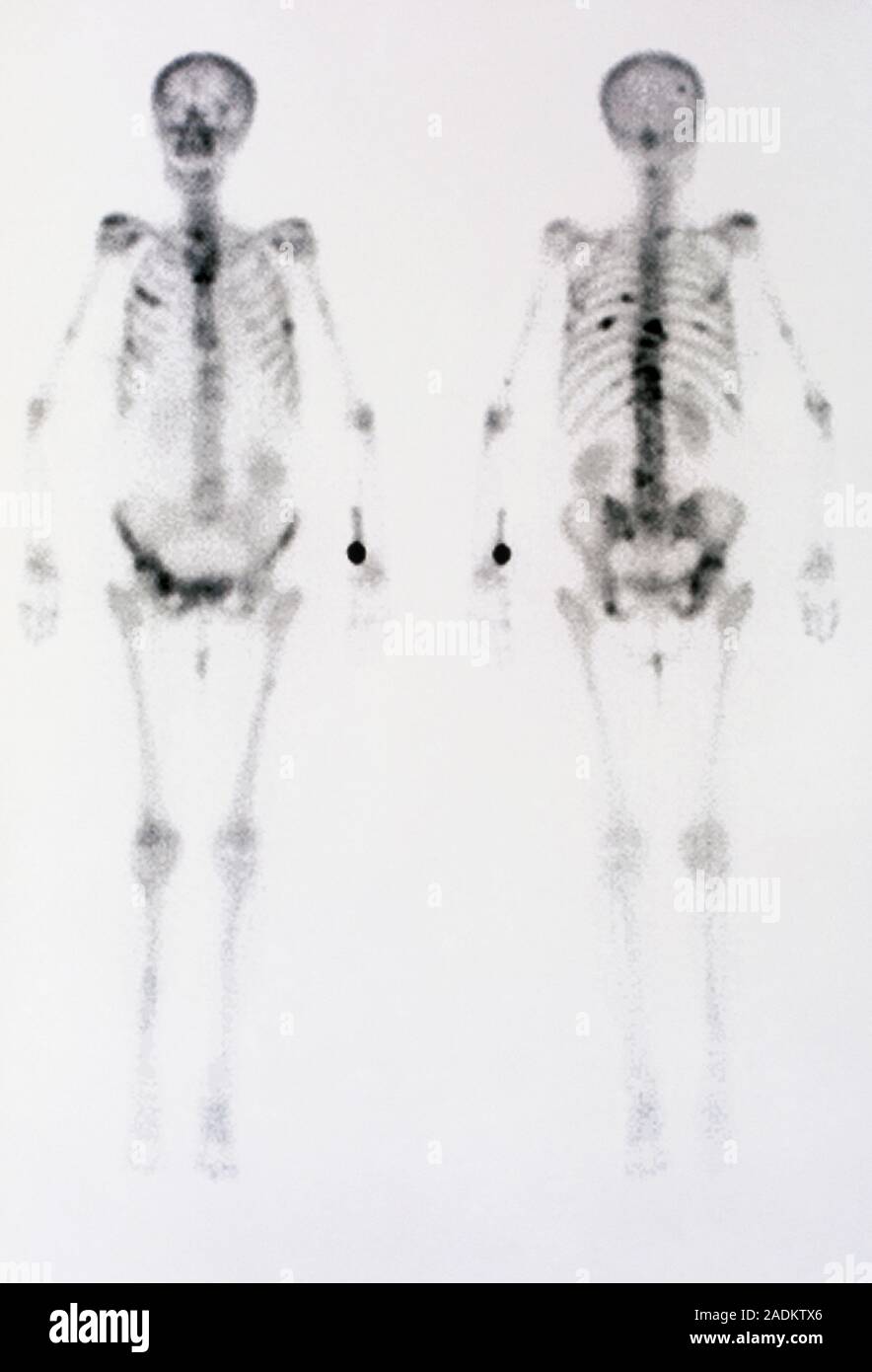 Skeleton. Gamma scans of a healthy human skeleton seen from the front ...