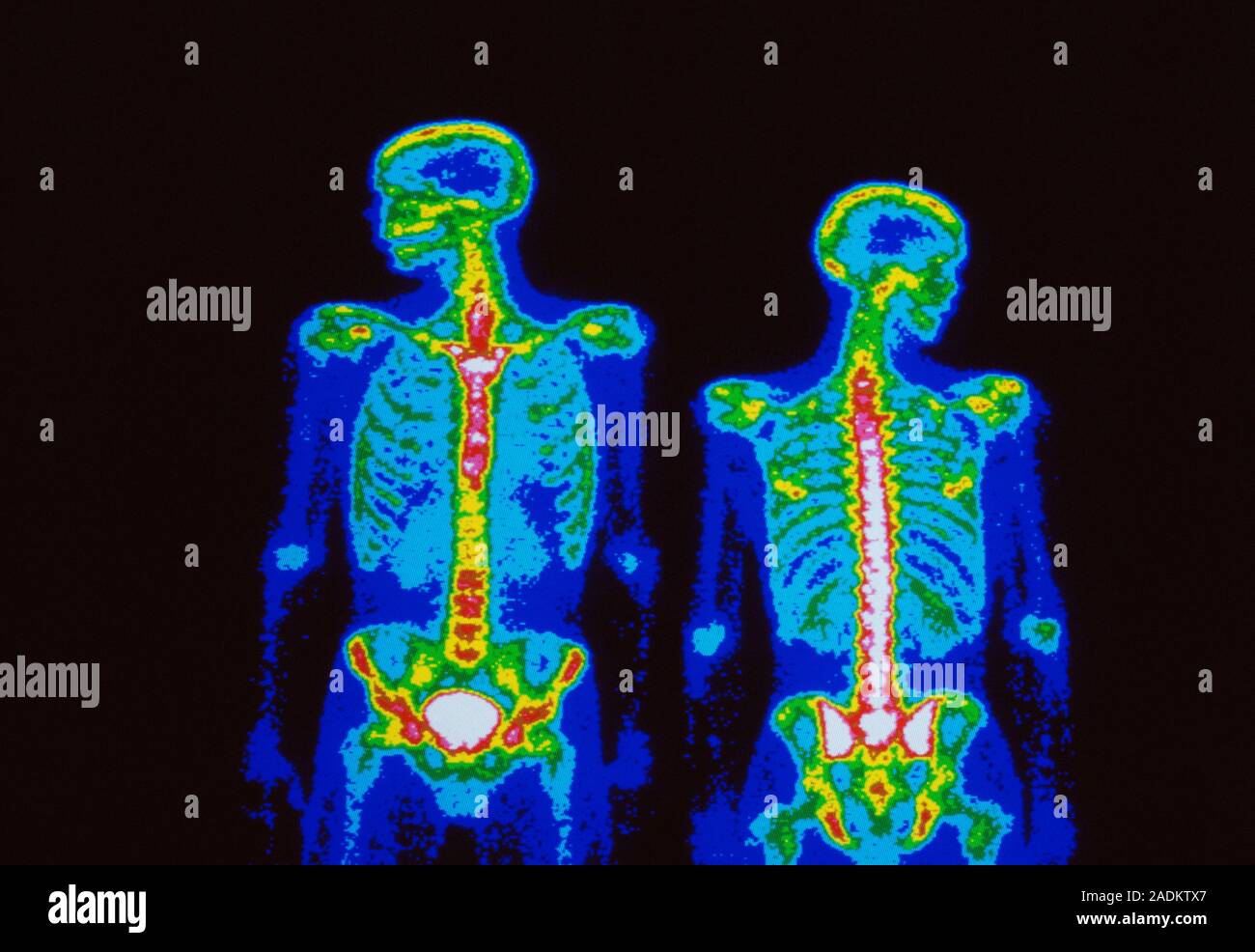 Male skeleton. Coloured frontal (left) and rear (right) gamma scans of ...
