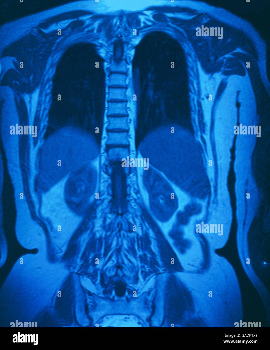 Thorax and abdomen. Magnetic Resonance Imaging (MRI) scan of the thorax ...