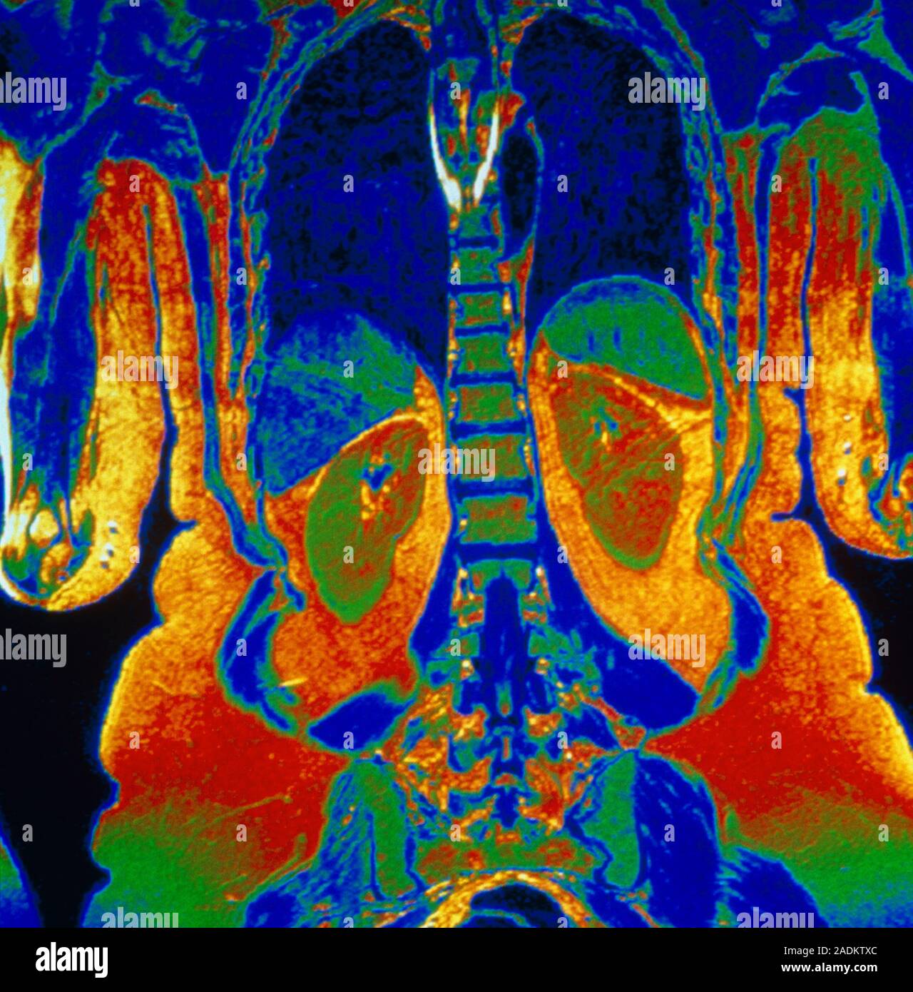 Thorax and abdomen. Coloured Magnetic Resonance Imaging (MRI) scan of ...