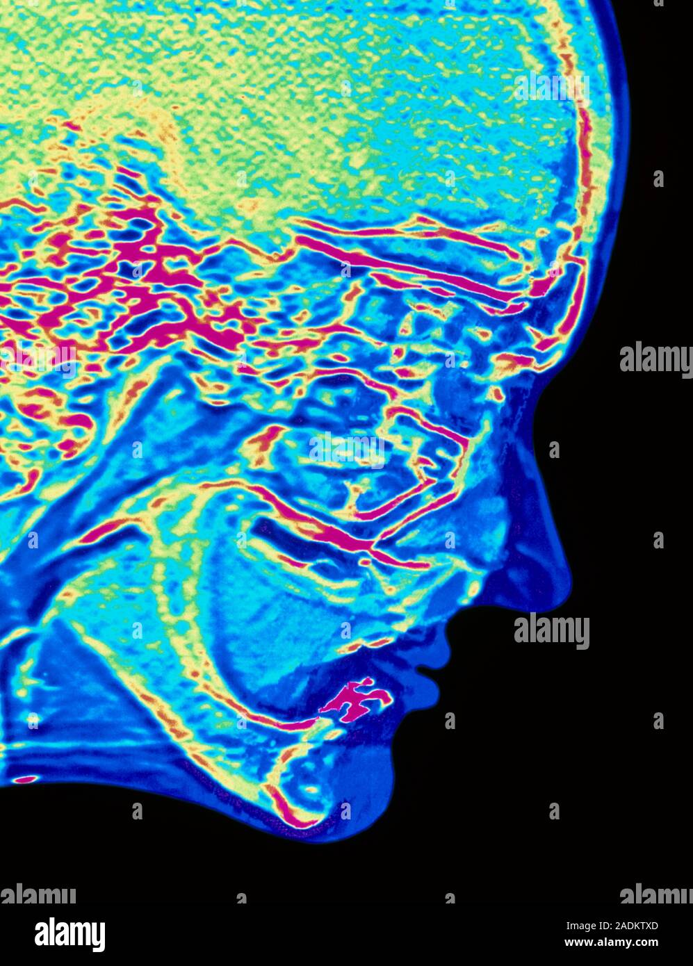 Human head. Coloured magnetic resonance imaging (MRI) scan of a ...