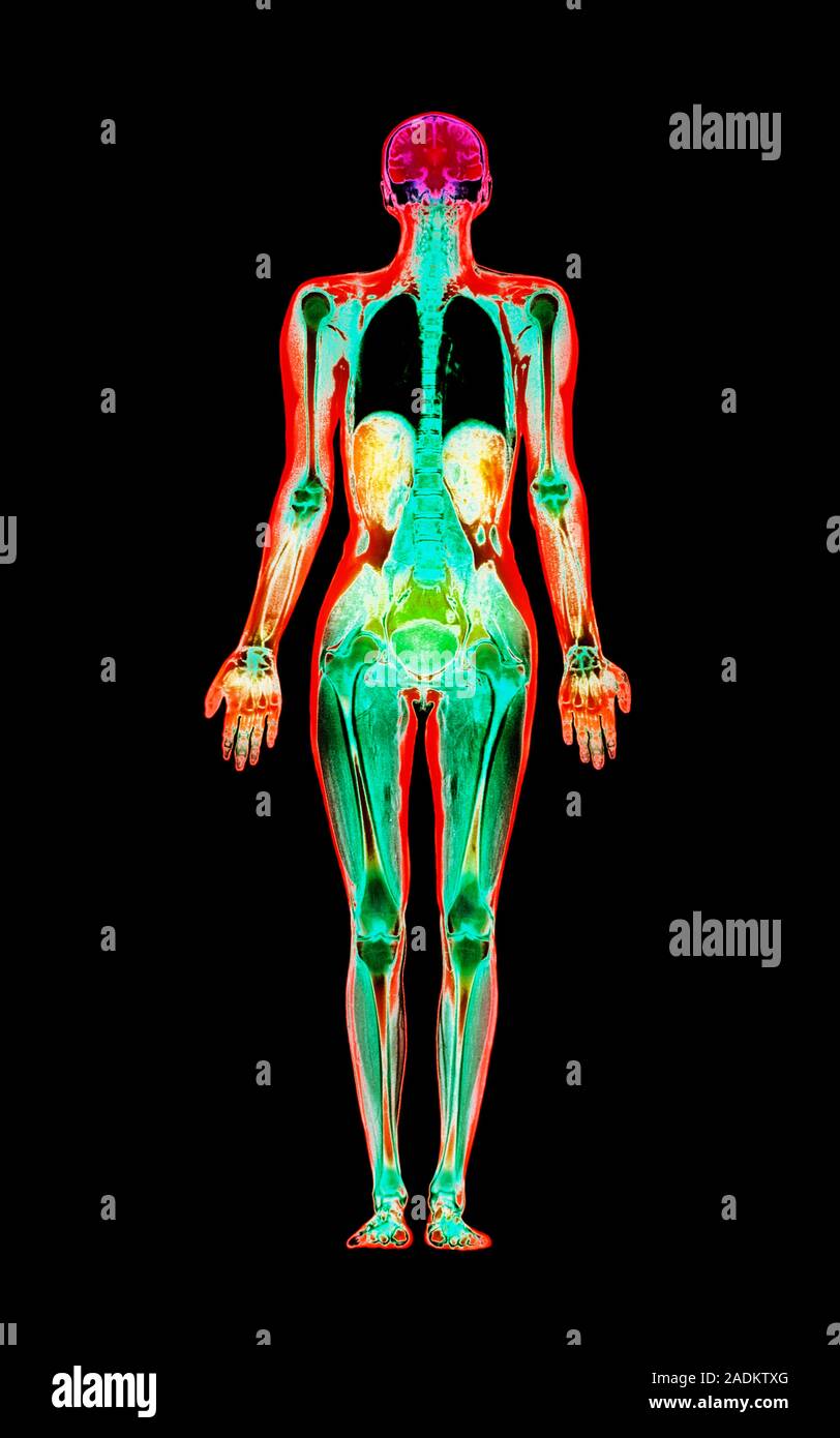 Whole body MRI. Coloured magnetic resonance imaging (MRI) scan of the whole body of a woman, in ...