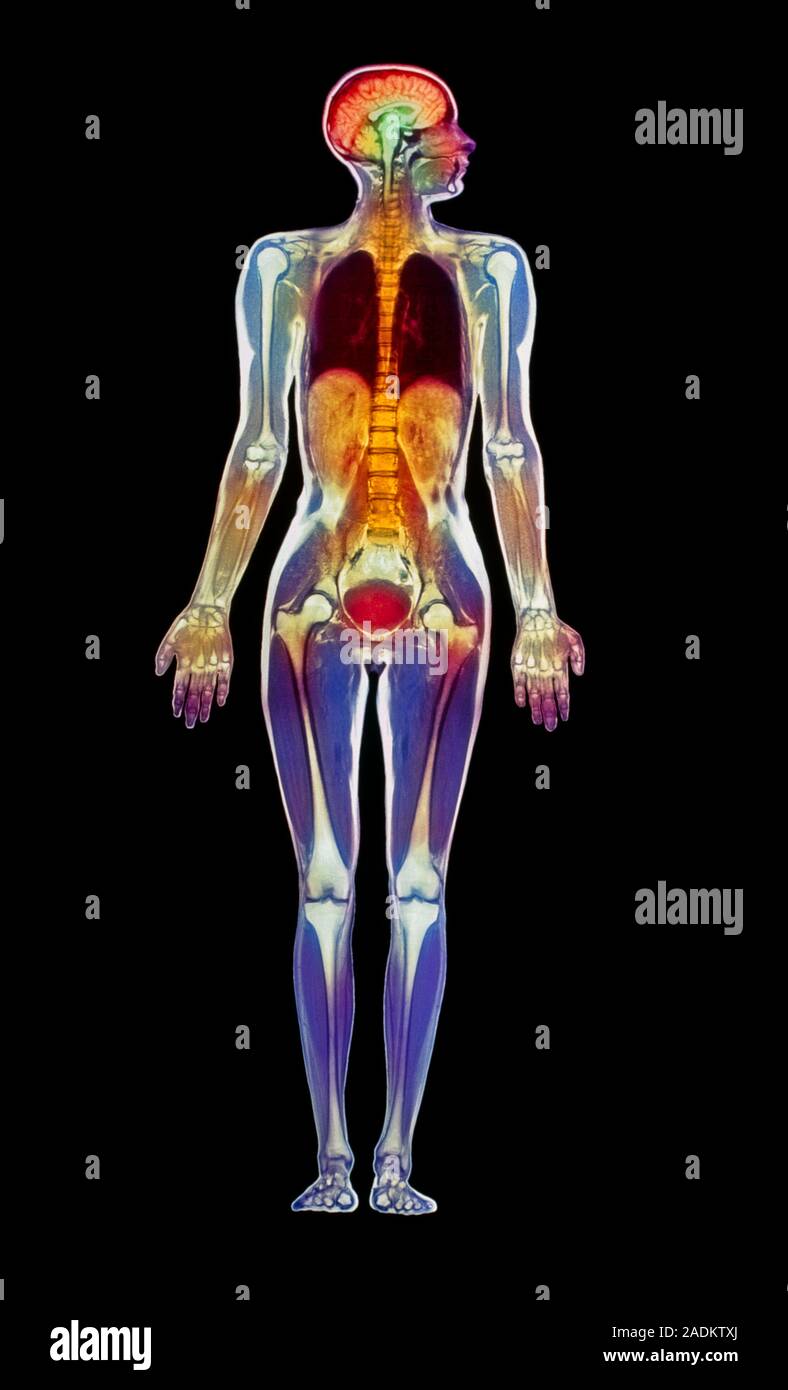Whole body MRI. Coloured magnetic resonance imaging (MRI) scan of the ...