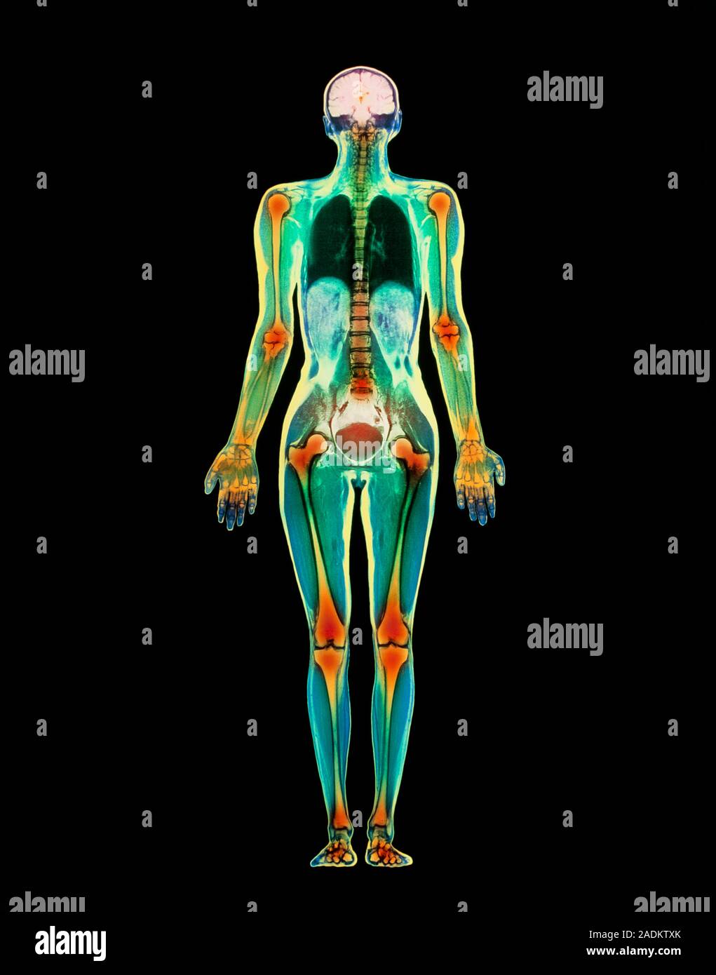 Whole body MRI. Coloured magnetic resonance imaging (MRI) scan of the ...
