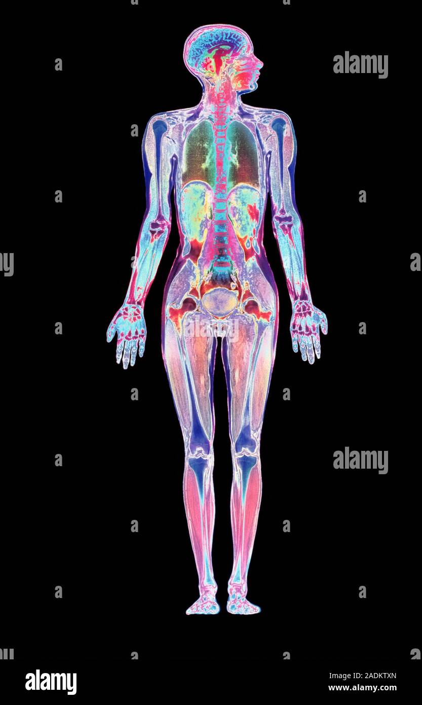 Whole body MRI. Coloured magnetic resonance imaging (MRI) scan of the ...