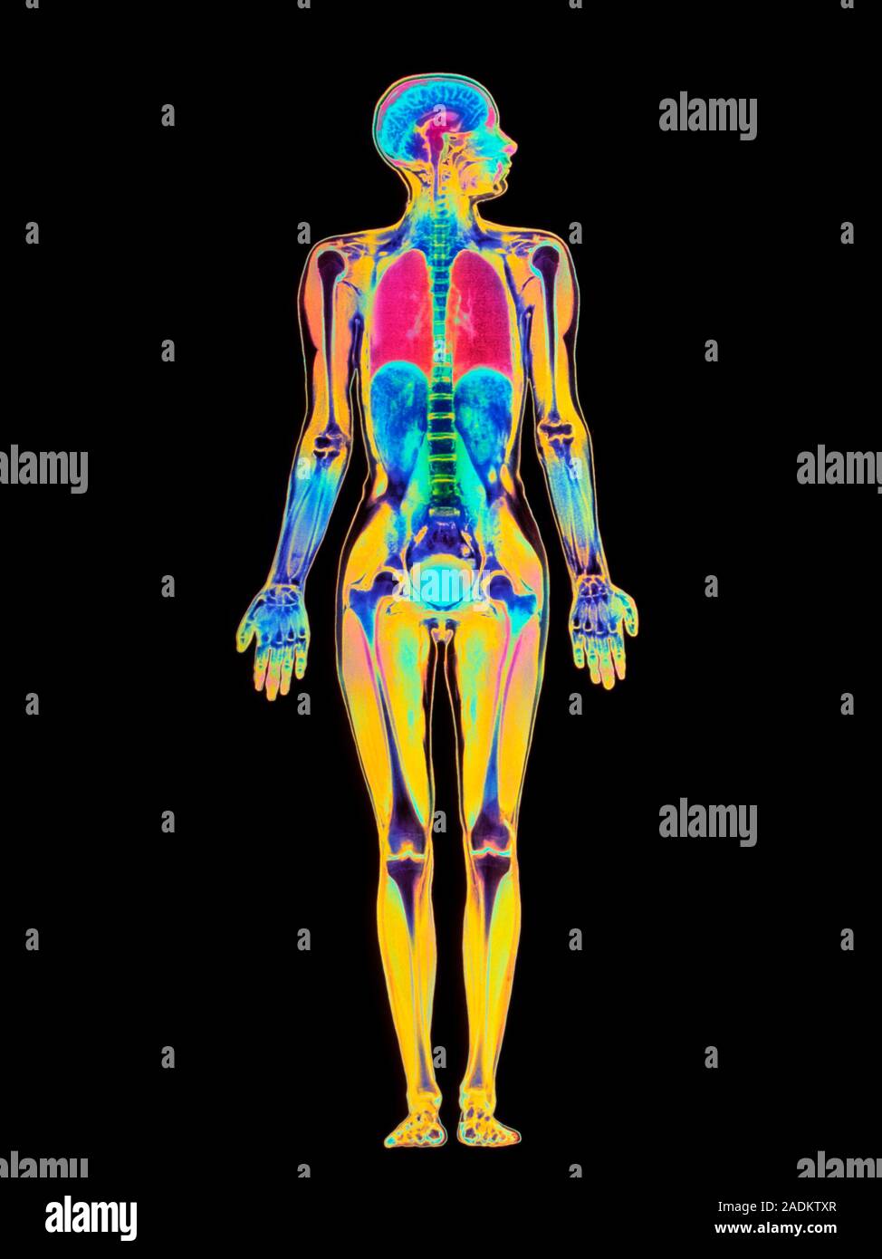 Whole body MRI. Coloured magnetic resonance imaging (MRI) scan of the ...