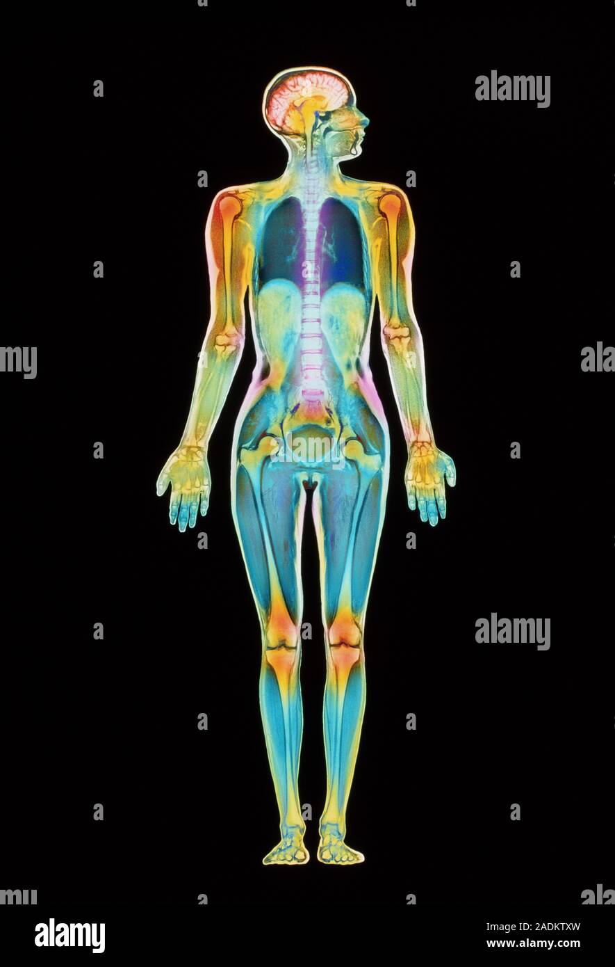 Whole body MRI. Coloured magnetic resonance imaging (MRI) scan of the ...