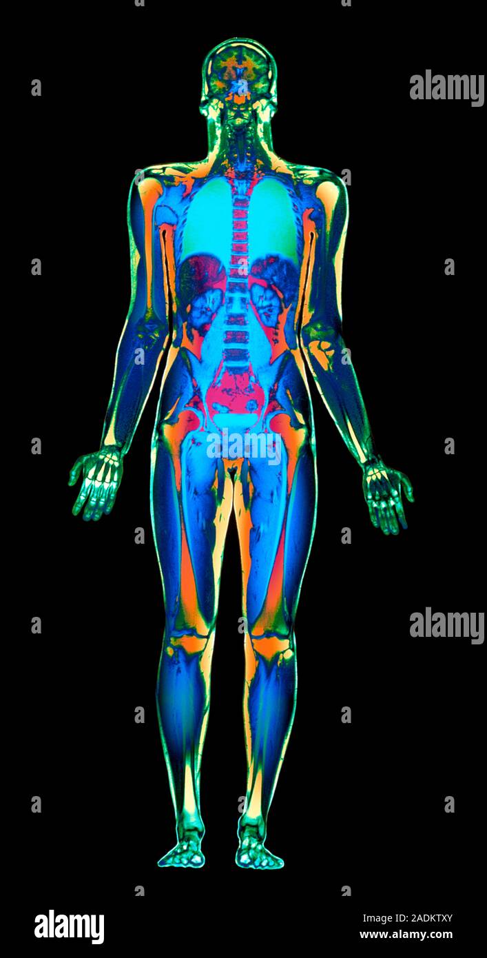 Whole body scan. Coloured magnetic resonance imaging (MRI) scan of the ...