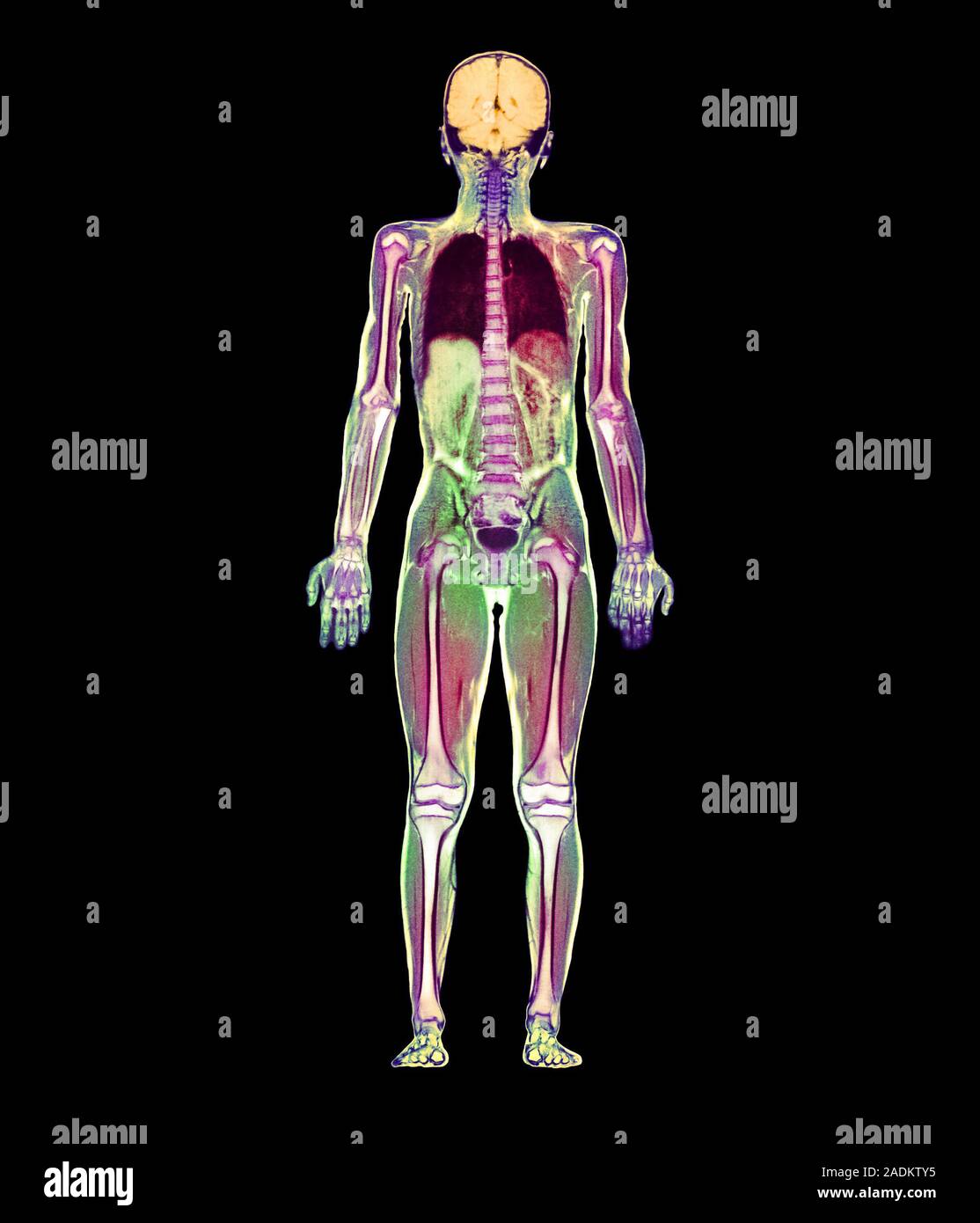Whole body scan. Coloured magnetic resonance imaging (MRI) whole body scan of a nine year old ...