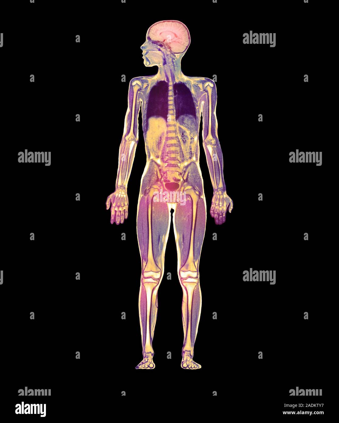 Whole body scan. Coloured magnetic resonance imaging (MRI) whole body ...