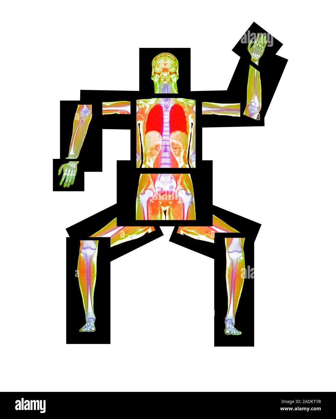 Whole body scans. Coloured magnetic resonance imaging (MRI) scans of a ...