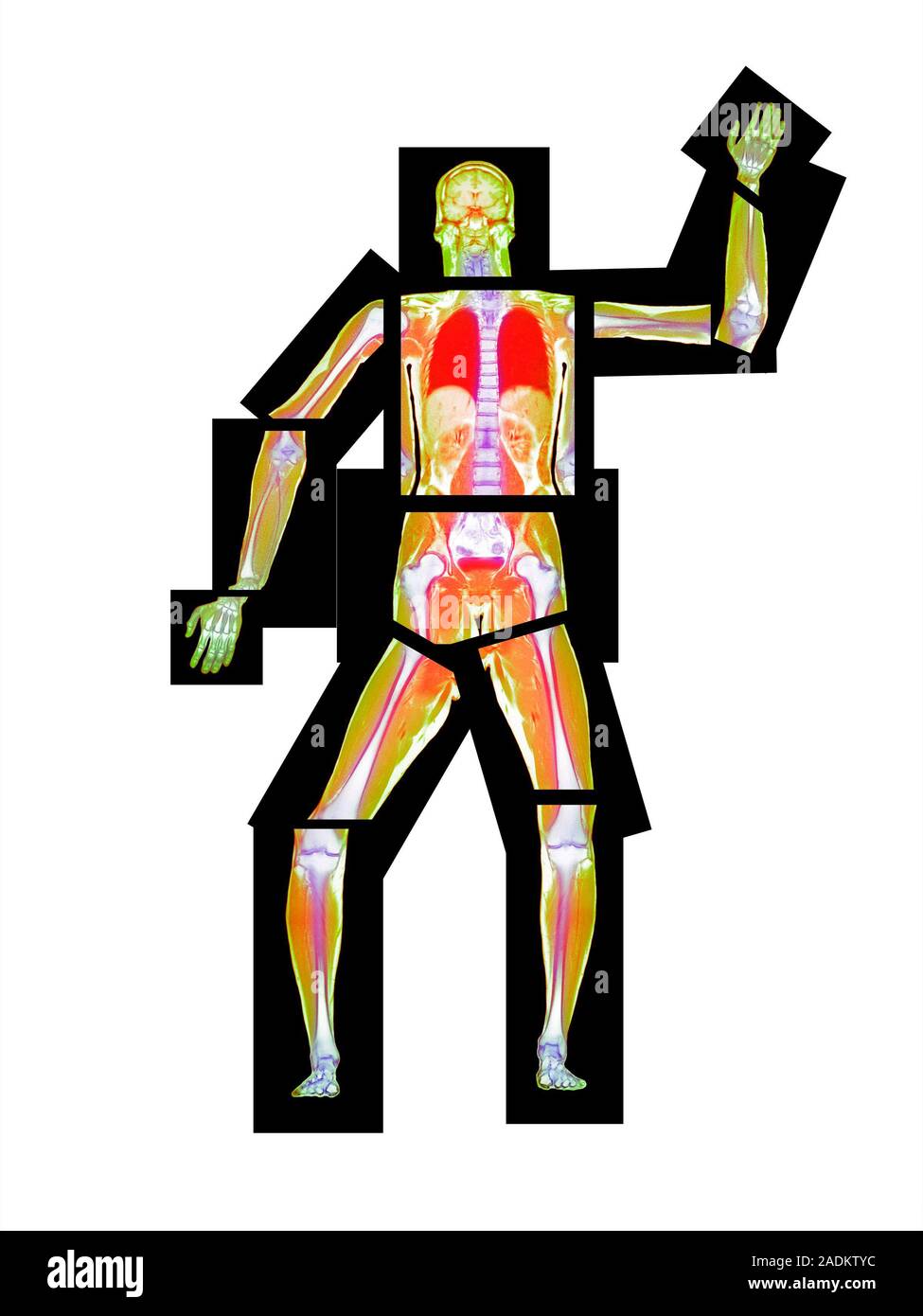 Whole body scans. Coloured magnetic resonance imaging (MRI) scans of a ...
