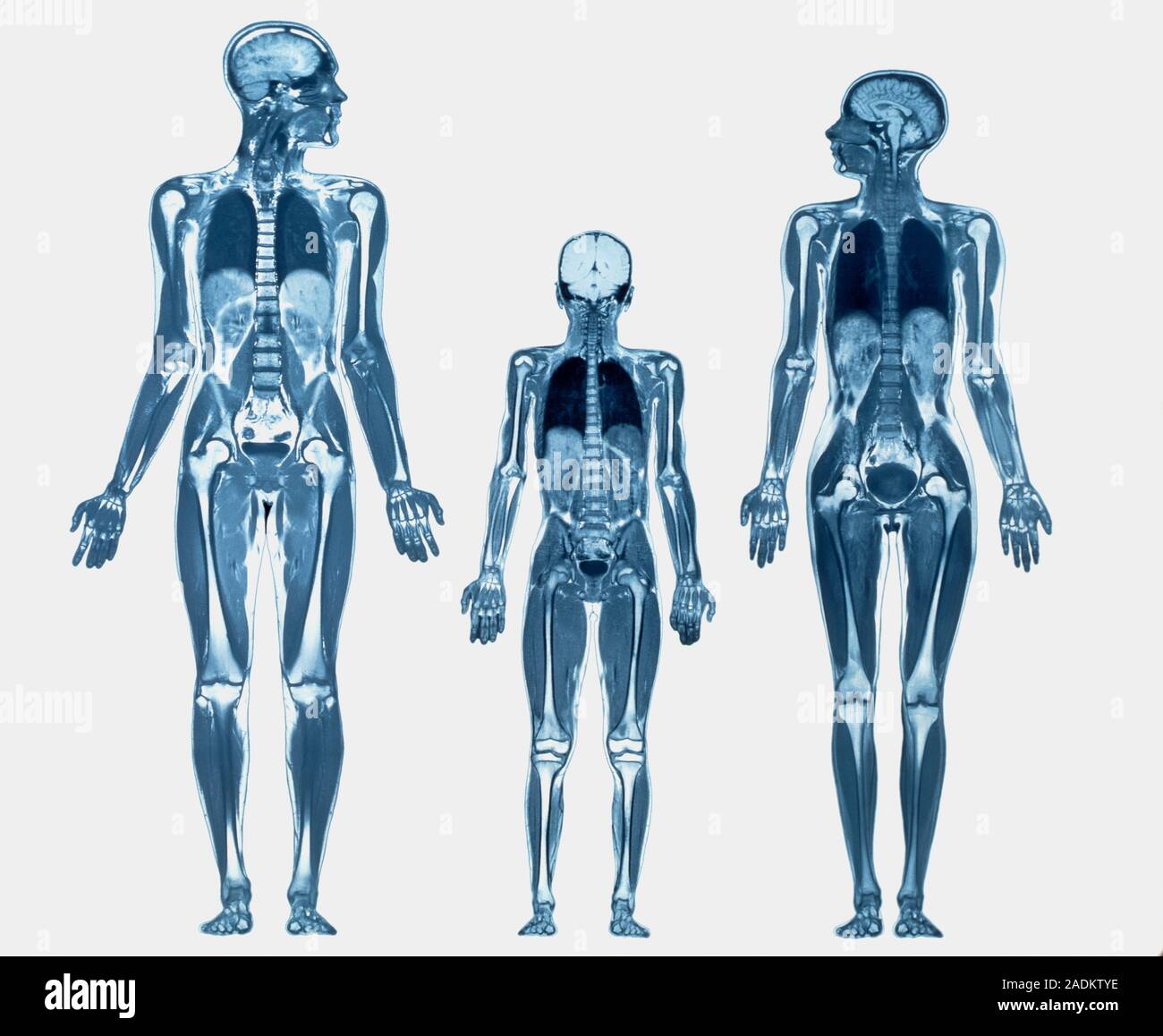 Whole body scans. Coloured magnetic resonance imaging (MRI) whole body ...