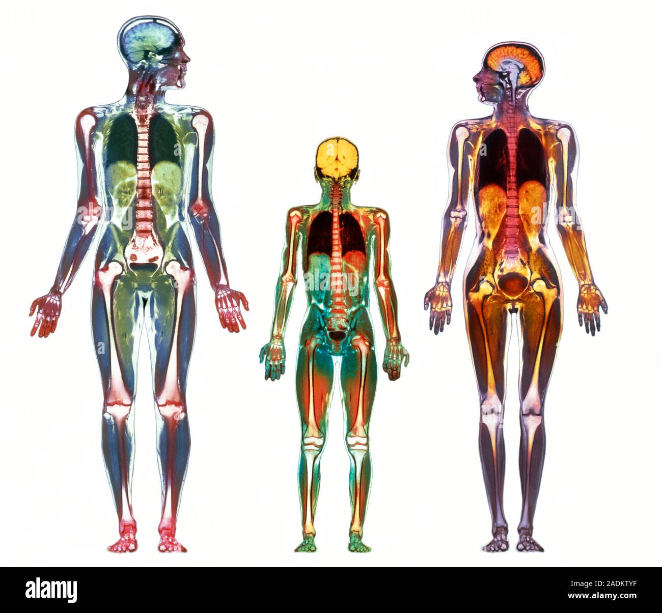 Whole body scans. Coloured magnetic resonance imaging (MRI) whole body scans of a man (left), a ...