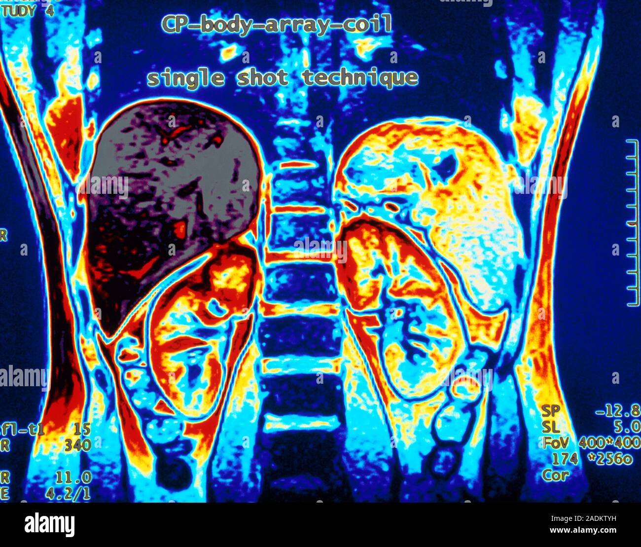 Abdomen. Coloured Magnetic Resonance Imaging (MRI) scan showing a coronal section through a ...