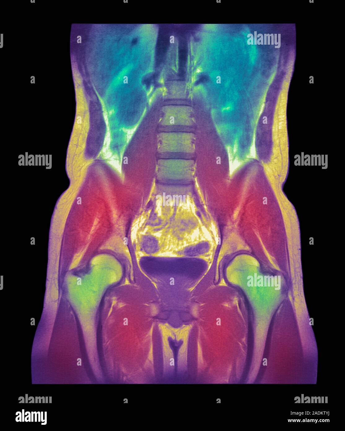 Abdominal scan. Coloured magnetic resonance imaging (MRI) scan of the ...