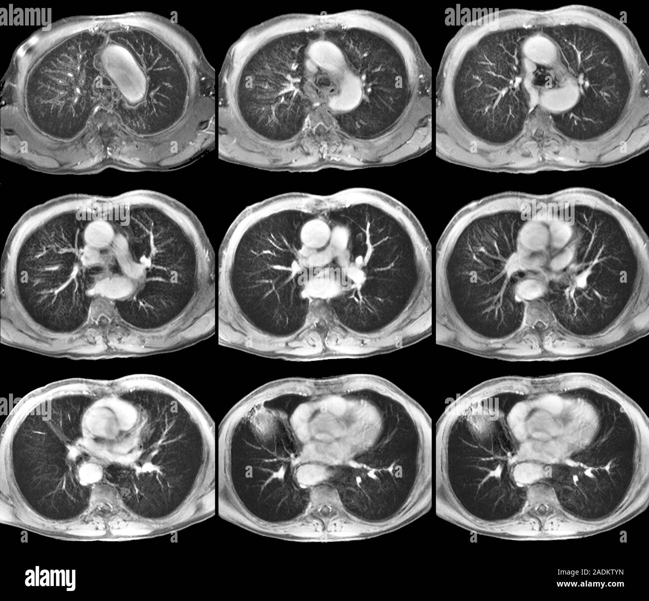 Healthy heart. Magnetic resonance imaging (MRI) scans of axial ...