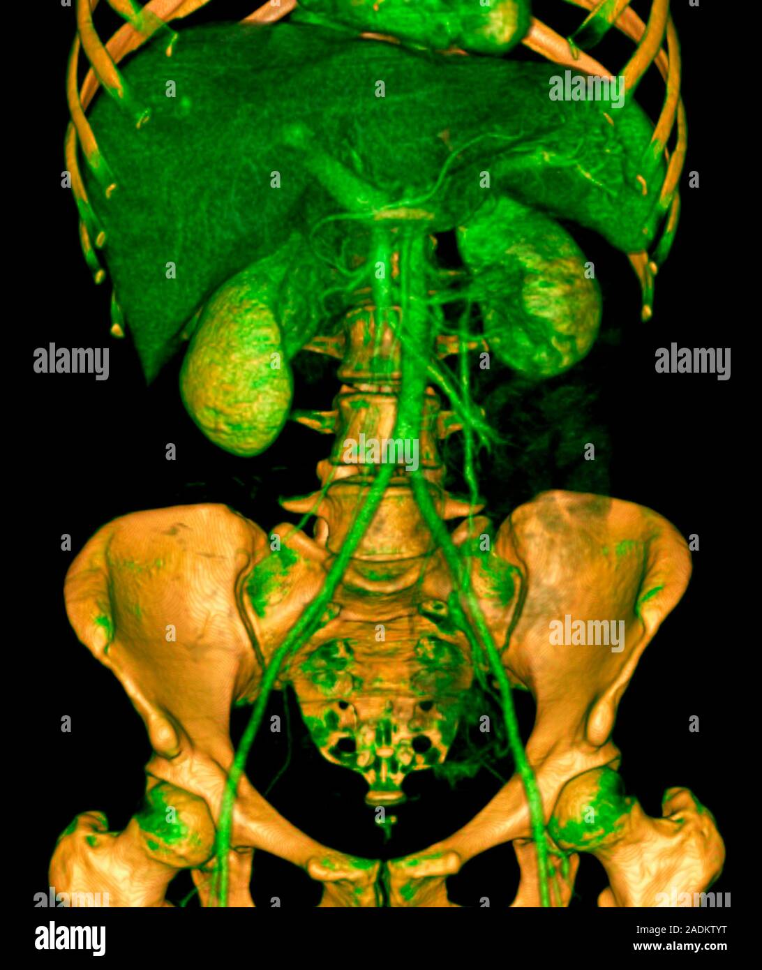 Abdomen, CT scan. Coloured three-dimensional computed tomography (CT) scan of an abdomen in ...