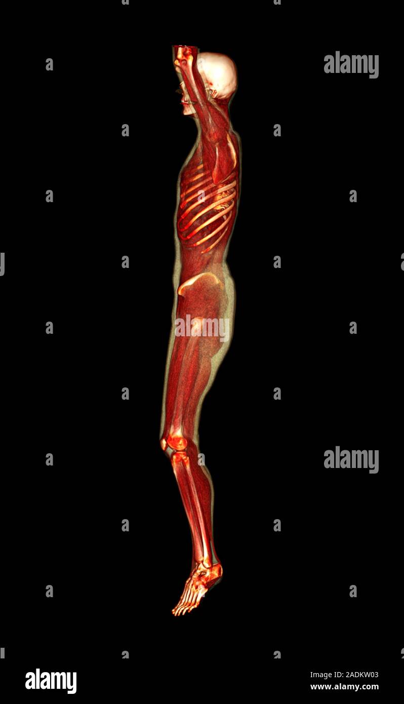 Female Body Ct Scan Three Dimensional Computed Tomography Ct Scan