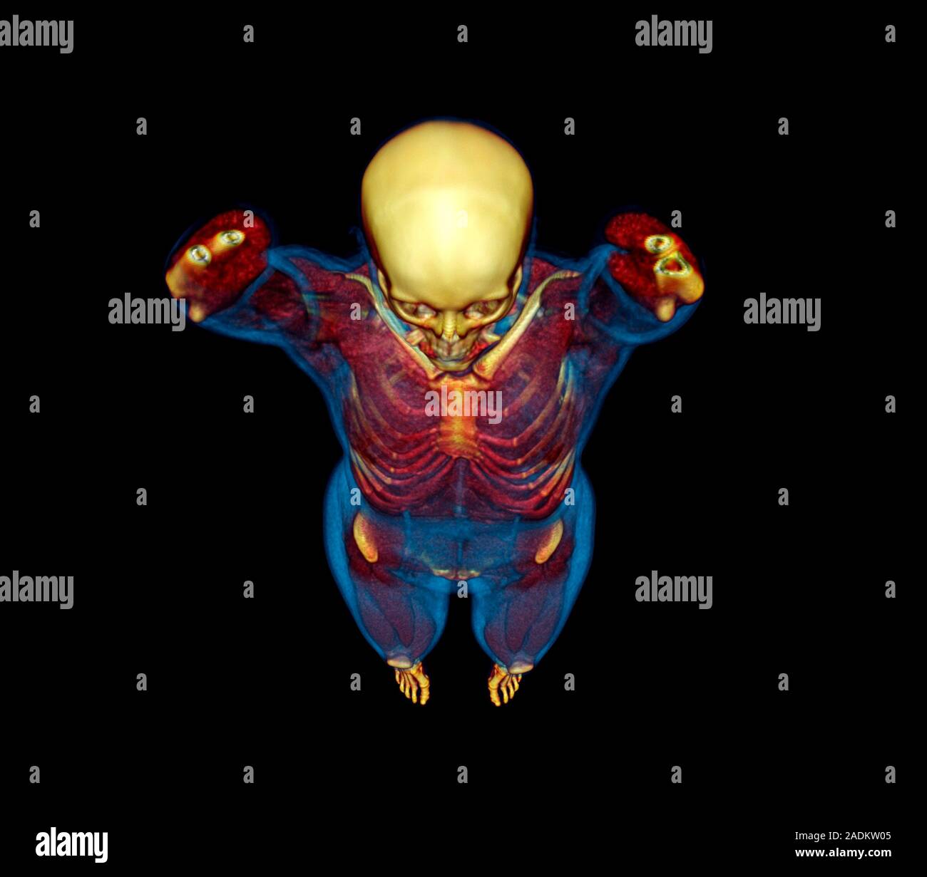 Female body, CT scan. Three-dimensional computed tomography (CT) scan ...