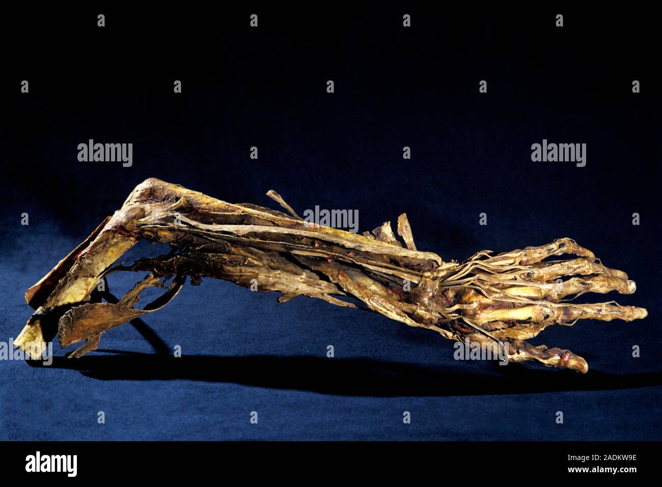 Human arm anatomy. Preserved dissected cadaver of a man's arm. The skin ...