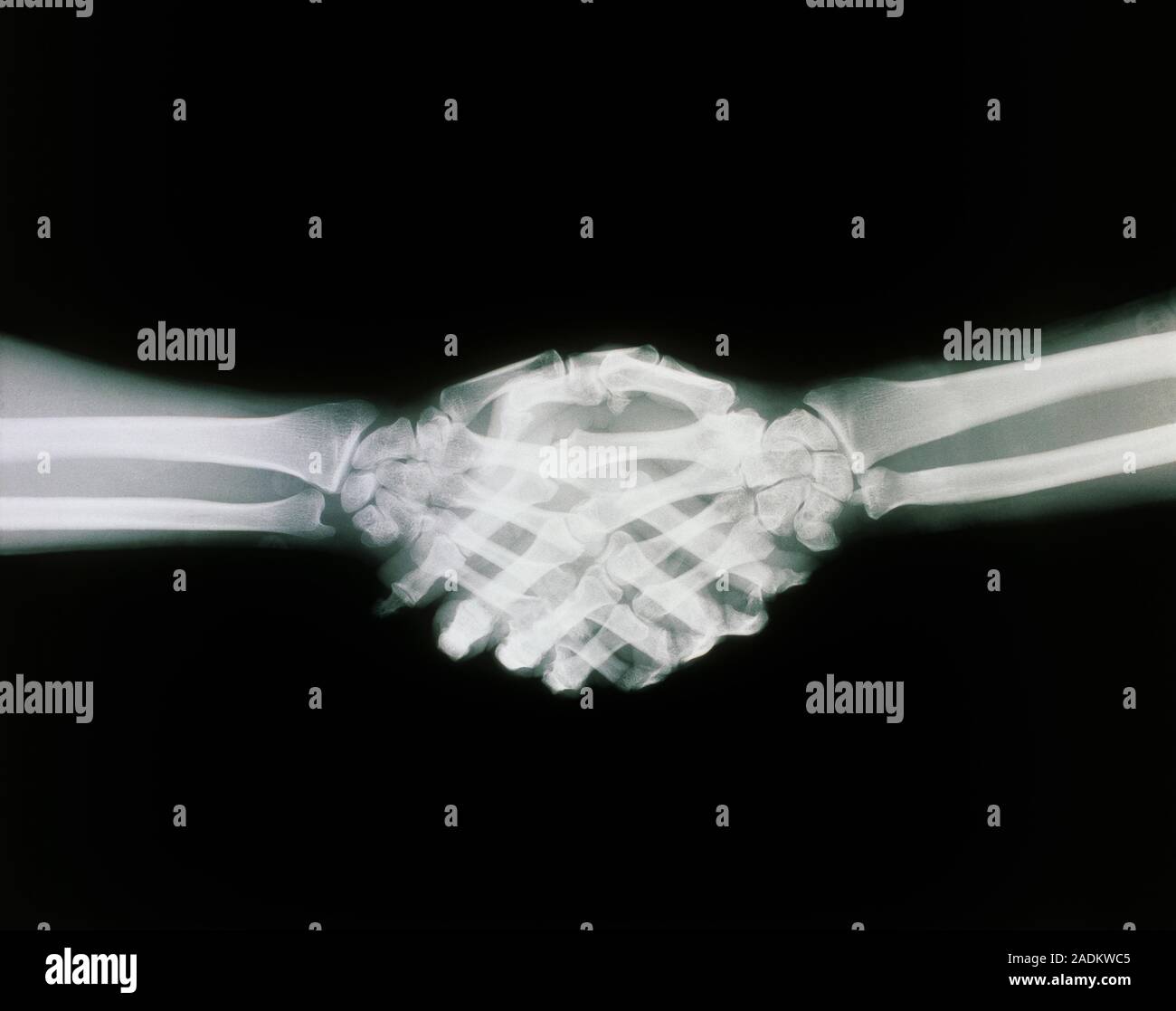 Handshake. X-ray of a handshake. This image may depict friendship ...