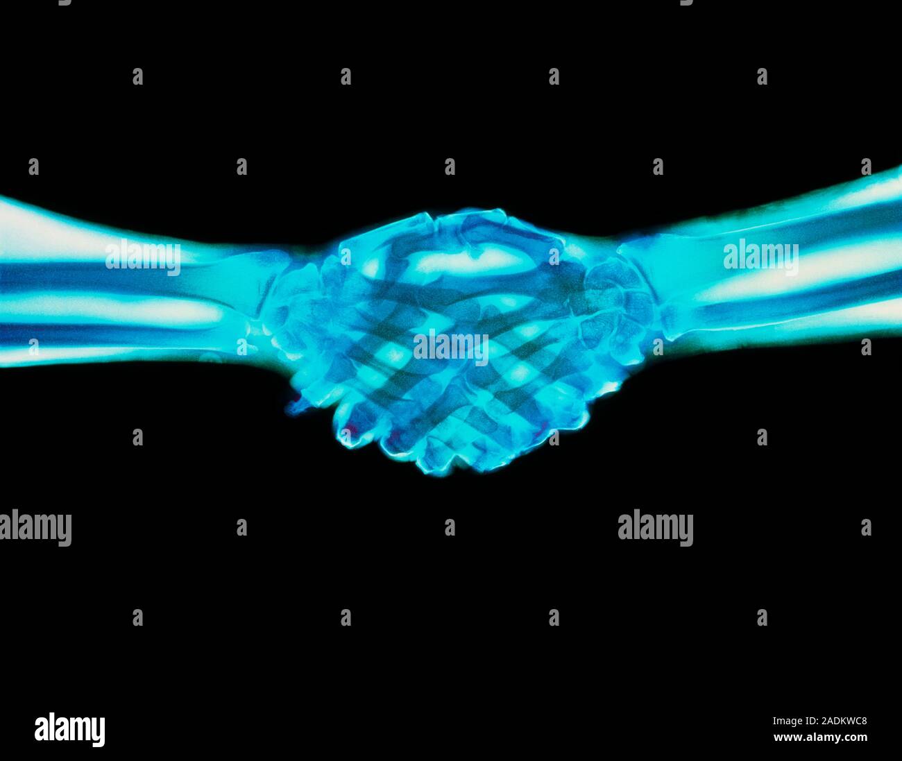 Handshake. Coloured X-ray of a handshake. This image may depict ...
