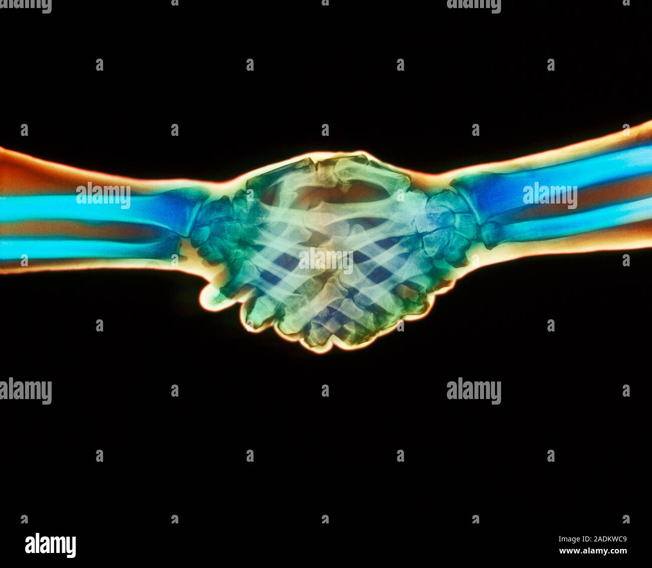 Handshake. Coloured X-ray of a handshake. This image may depict ...