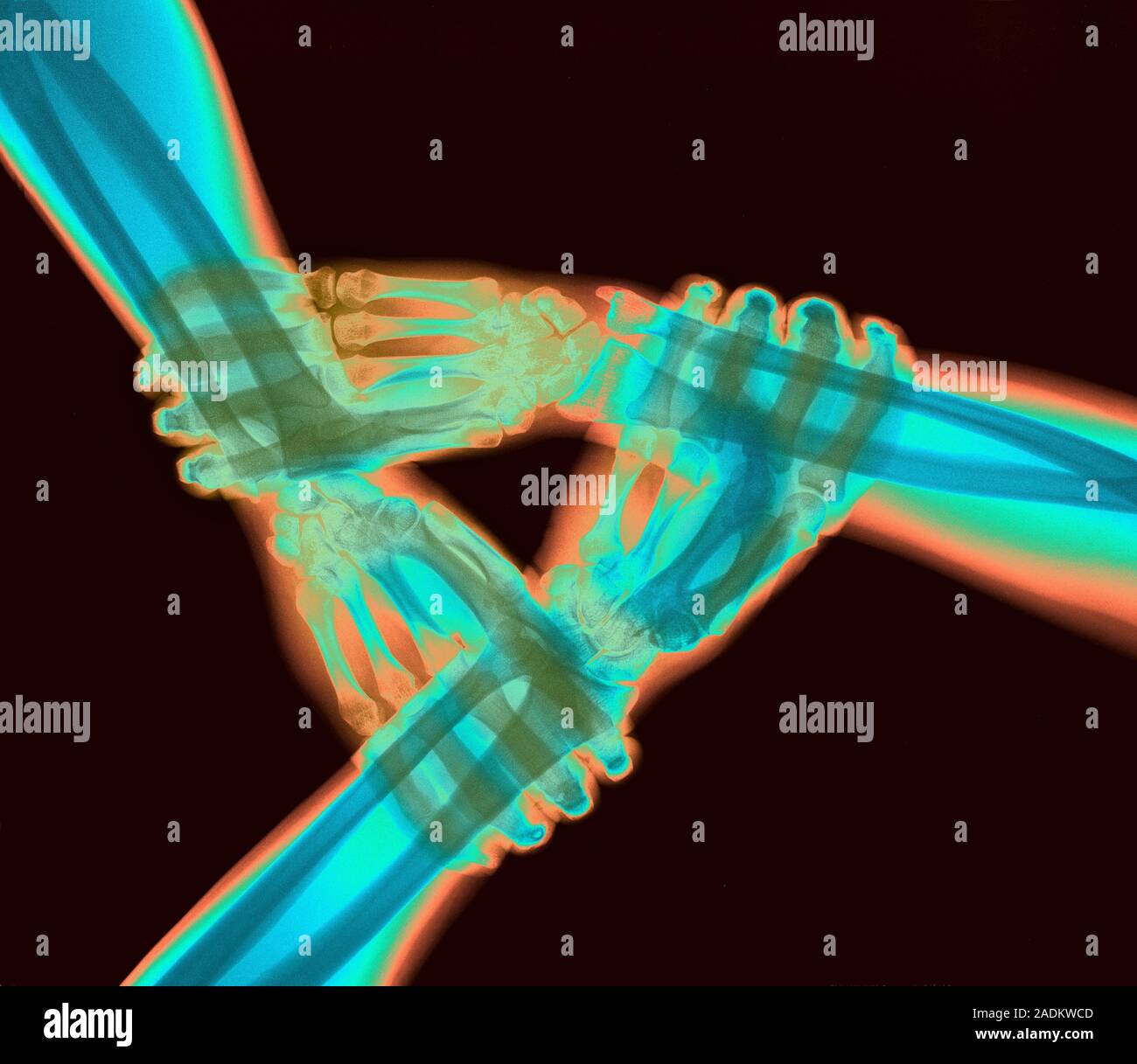 Holding hands. Coloured X-ray of three healthy hands linked up in a ...