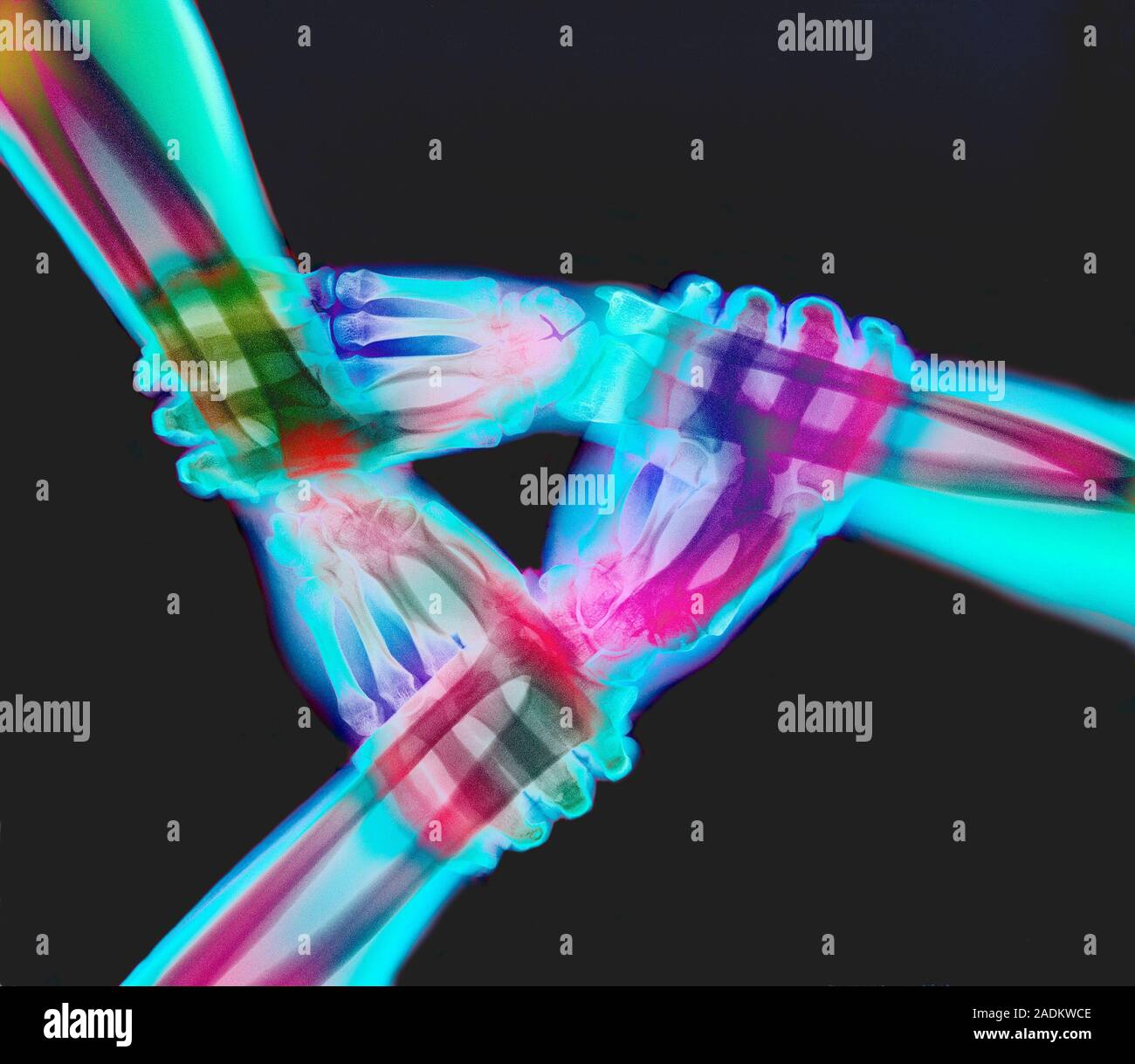 Holding hands. Coloured X-ray of three healthy hands linked up in a ...