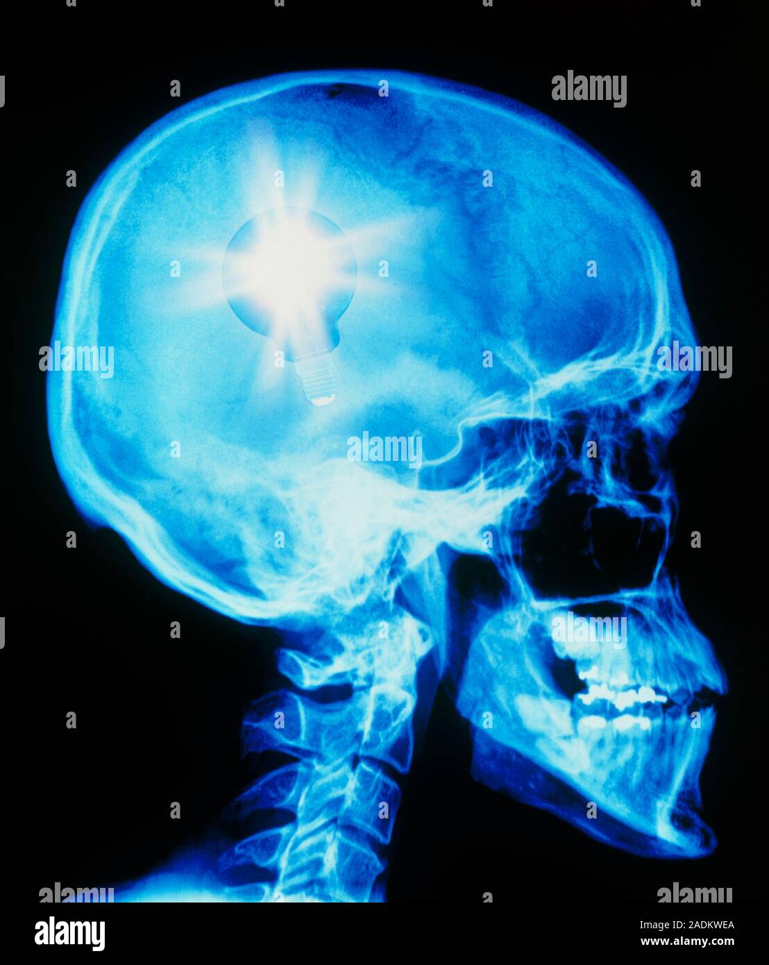Idea. Conceptual image of a glowing light bulb superimposed on an X-ray ...