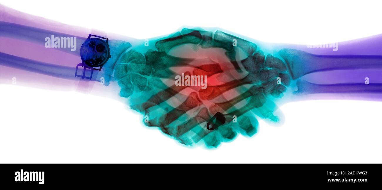 Handshake. Coloured X-ray of a handshake. This may depict friendship, a ...