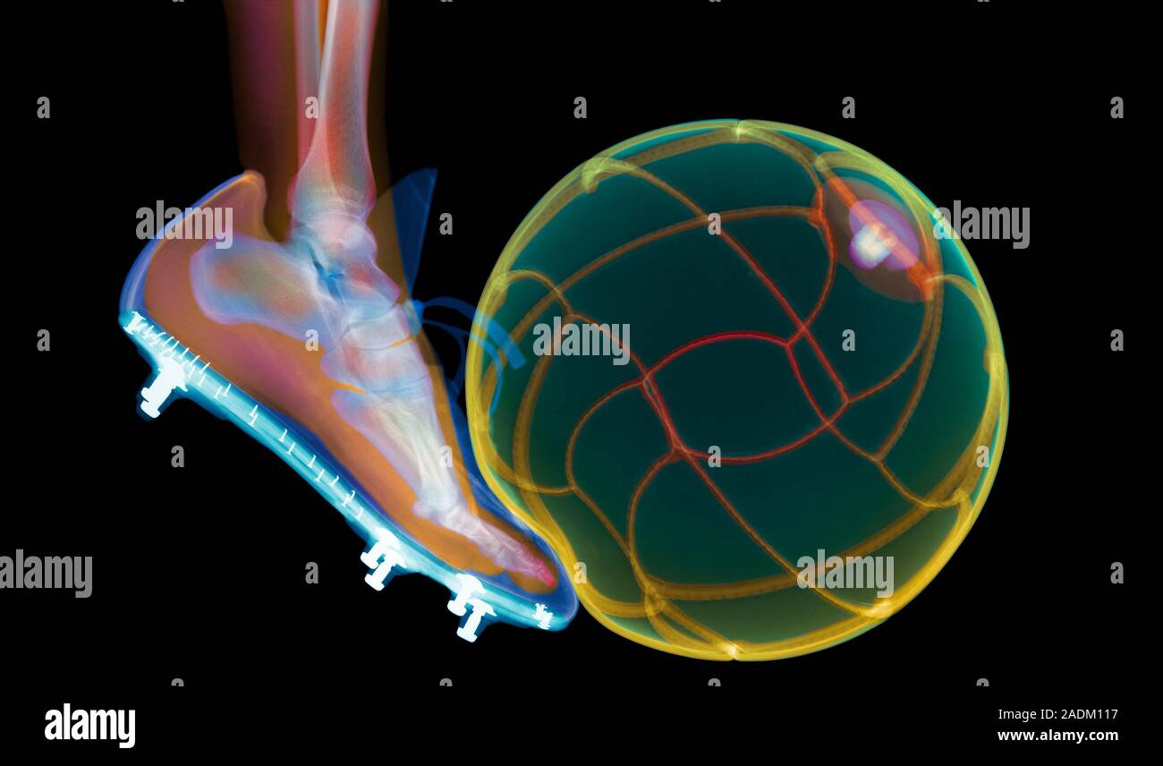 Football. Coloured X-ray of a footballer kicking a football. The ...