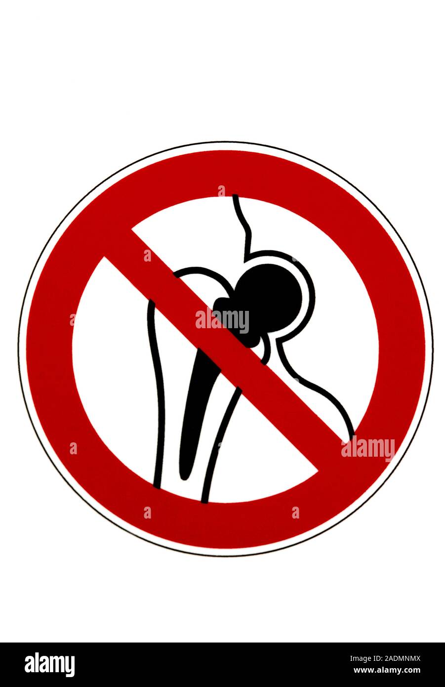 Artificial implant warning sign. Sign warning those with an artificial ...