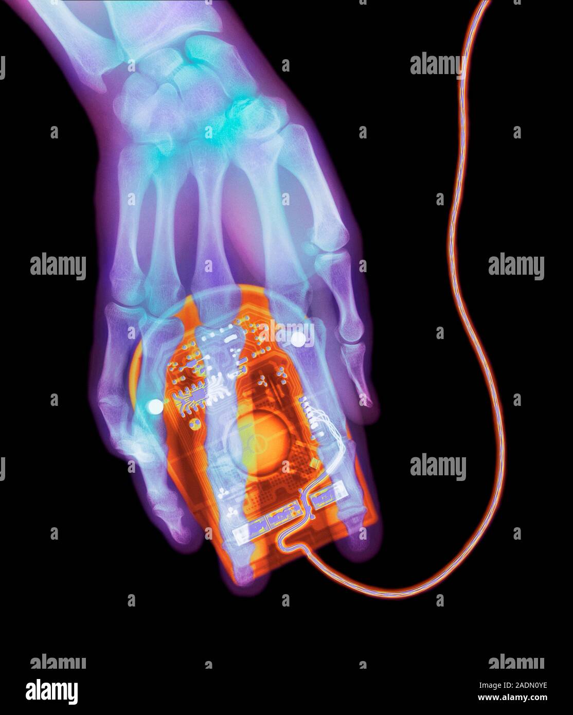 Computer mouse. Coloured X-ray of a computer mouse being held and ...