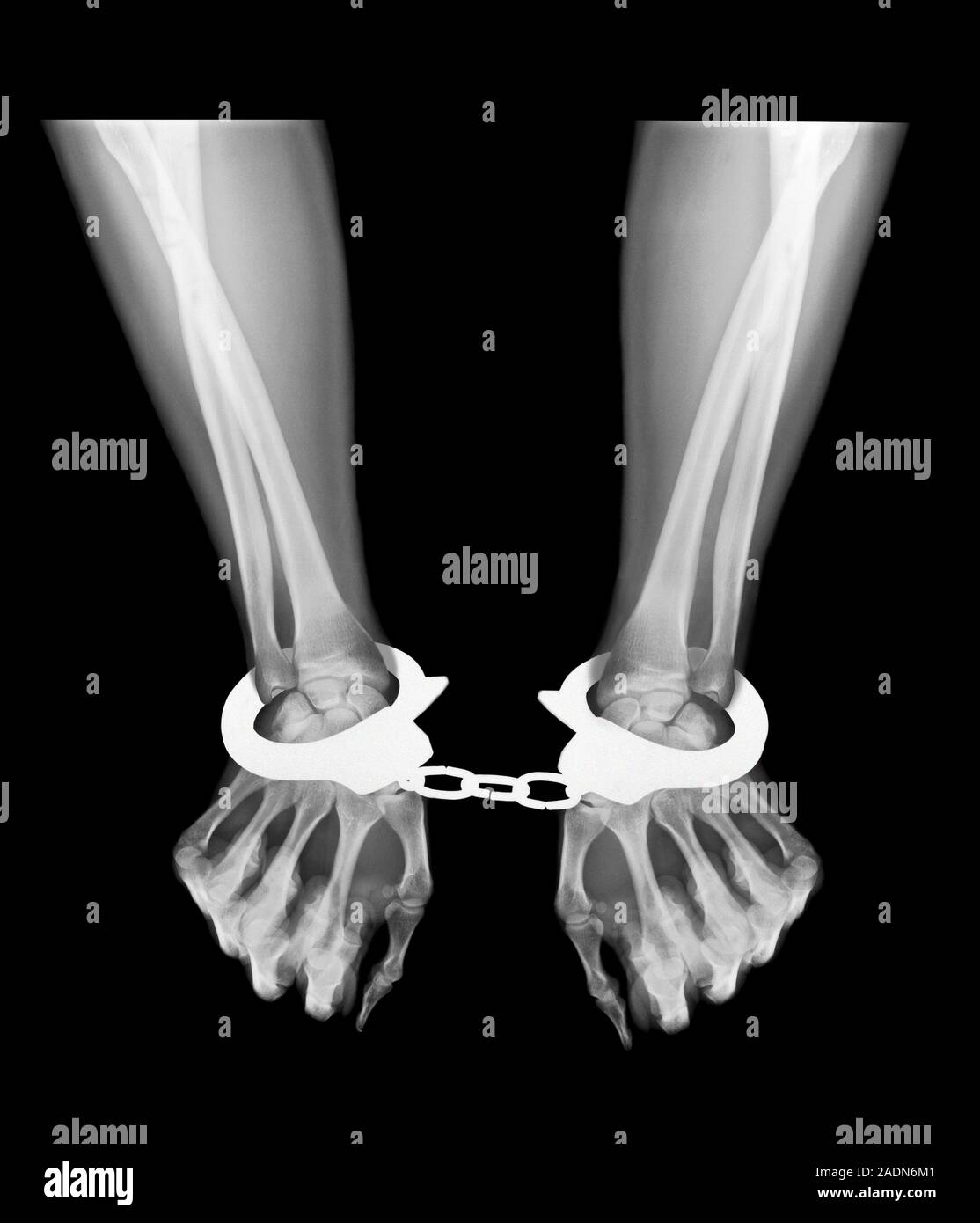 Handcuffed hands. X-ray of handcuffed hands. Handcuffs are used by ...
