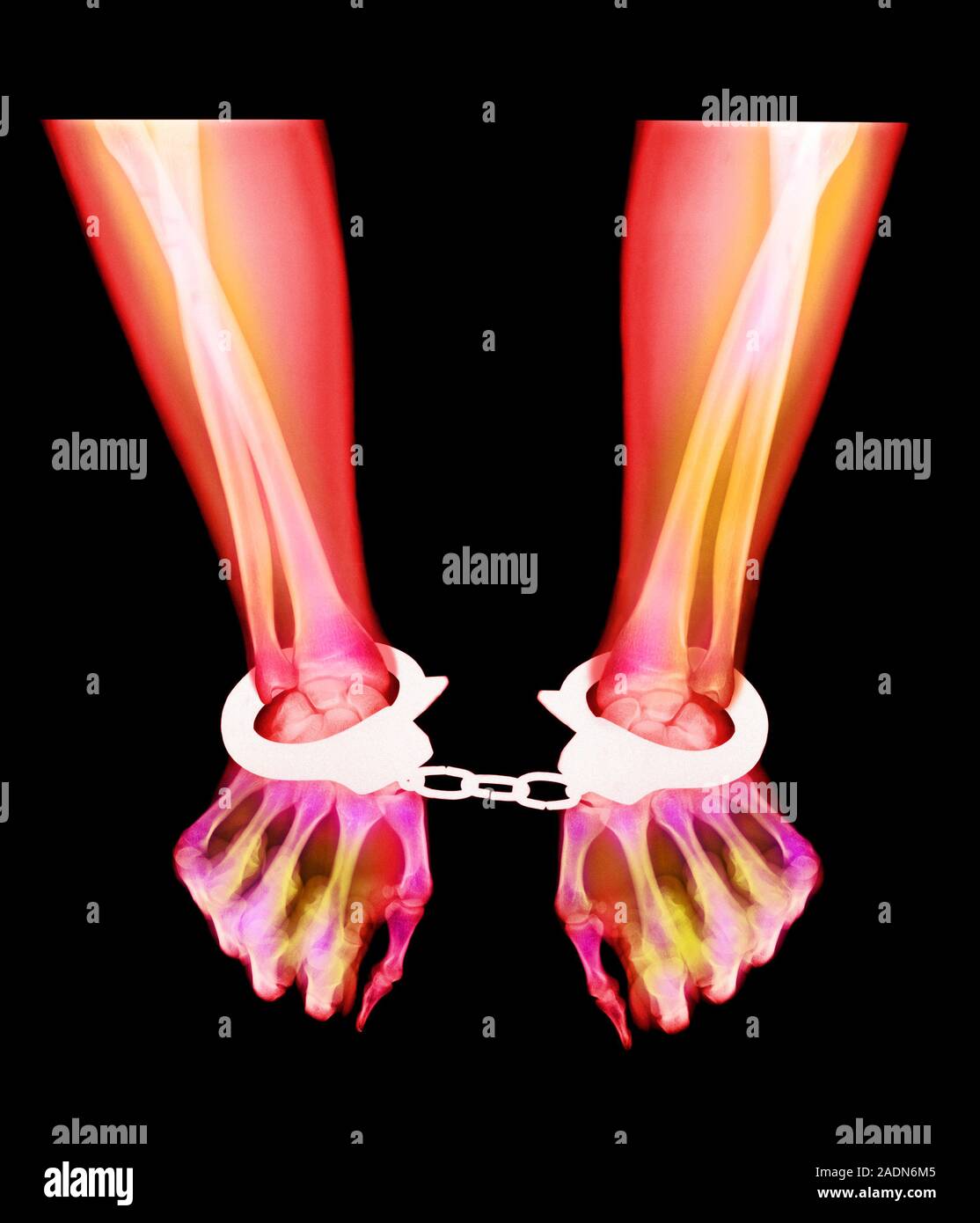 Handcuffed hands. Coloured X-ray of handcuffed hands. Handcuffs are ...