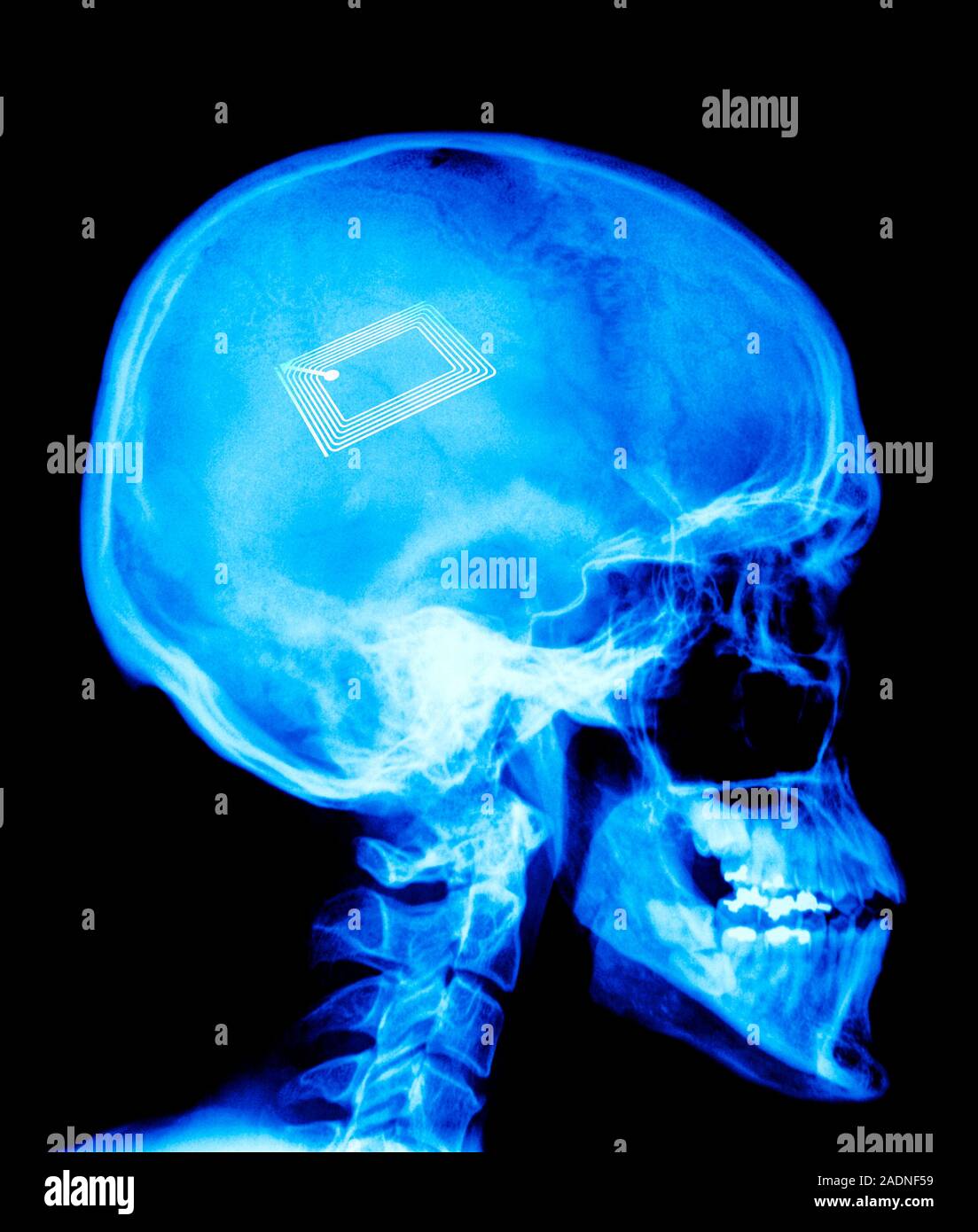 Security chip in a human skull. Conceptual computer artwork of a ...
