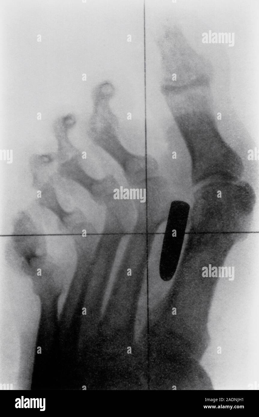 Bullet lodged in soldier's foot (1899). Historical X-ray of the foot of ...