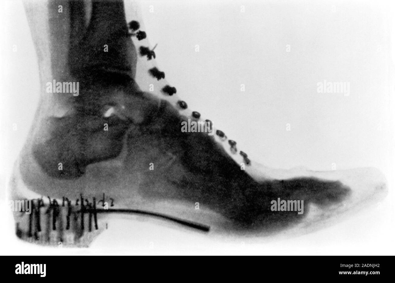 X-ray of a woman's foot and boot (1896). Early radiograph of a woman's ...