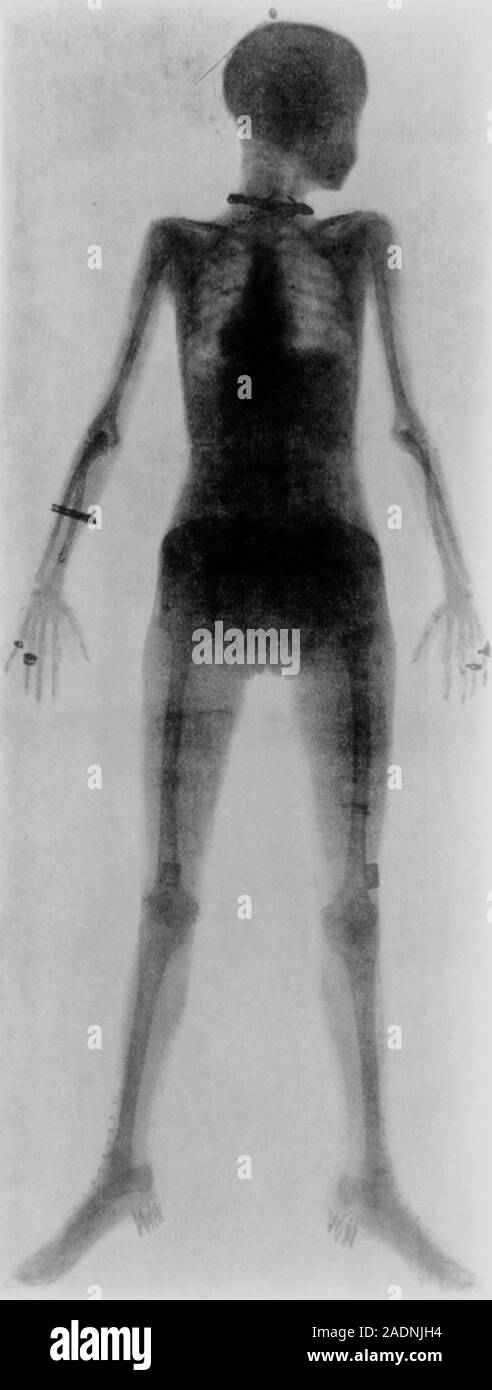 First whole body X-ray (1907). The first whole body radiograph ever ...