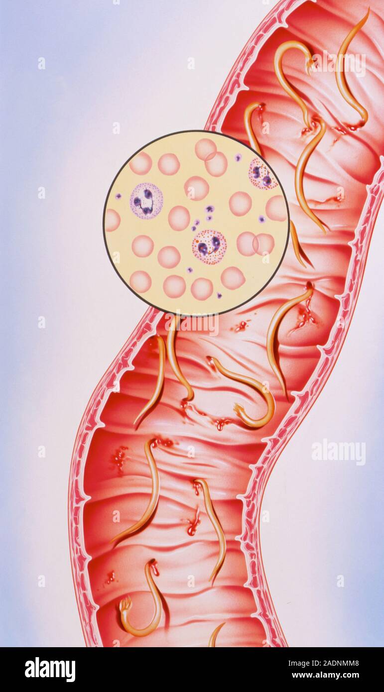 Hookworm & anaemia. Artwork of hookworm (Necator americanus ...