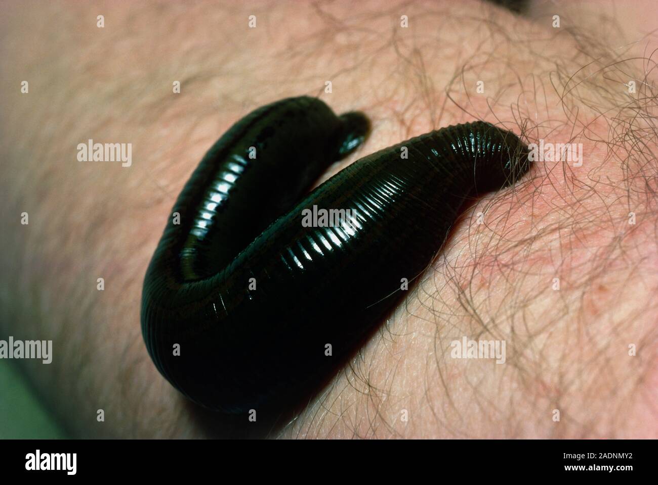 The medicinal leech Hirudo medicinalis sucking blood from a human arm ...