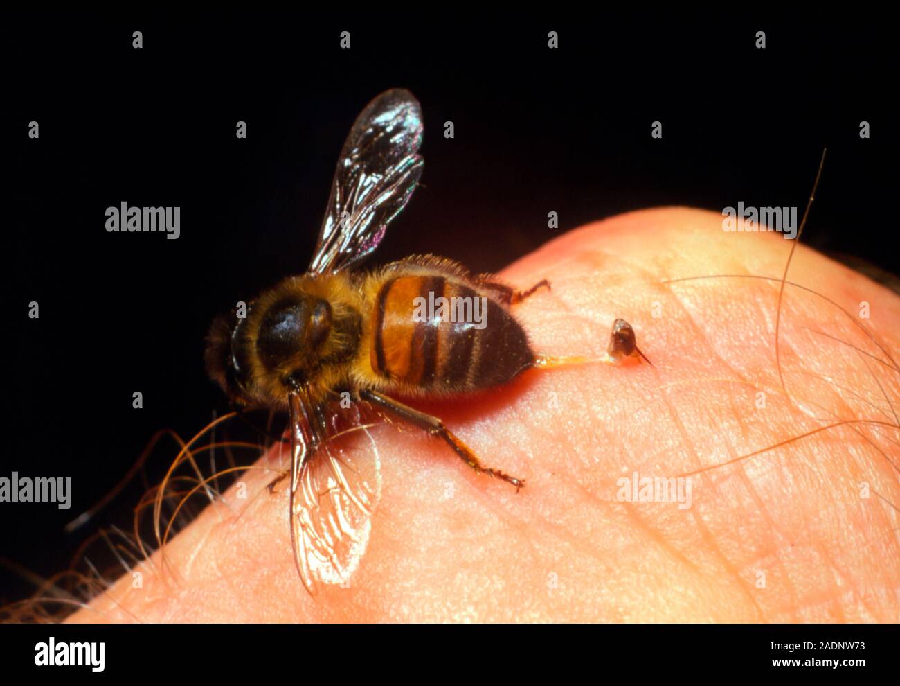 Bee sting. View of a honeybee Apis mellifera in the process of stinging a human finger. At ...