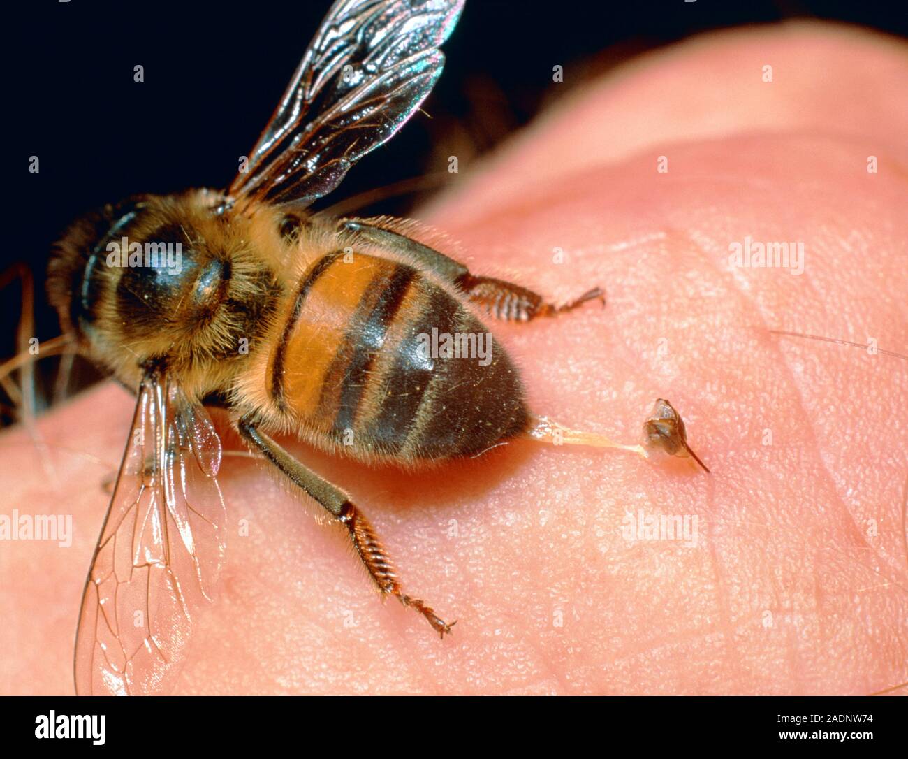 Bee sting. View of a honeybee Apis mellifera in the process of stinging a human finger. At ...