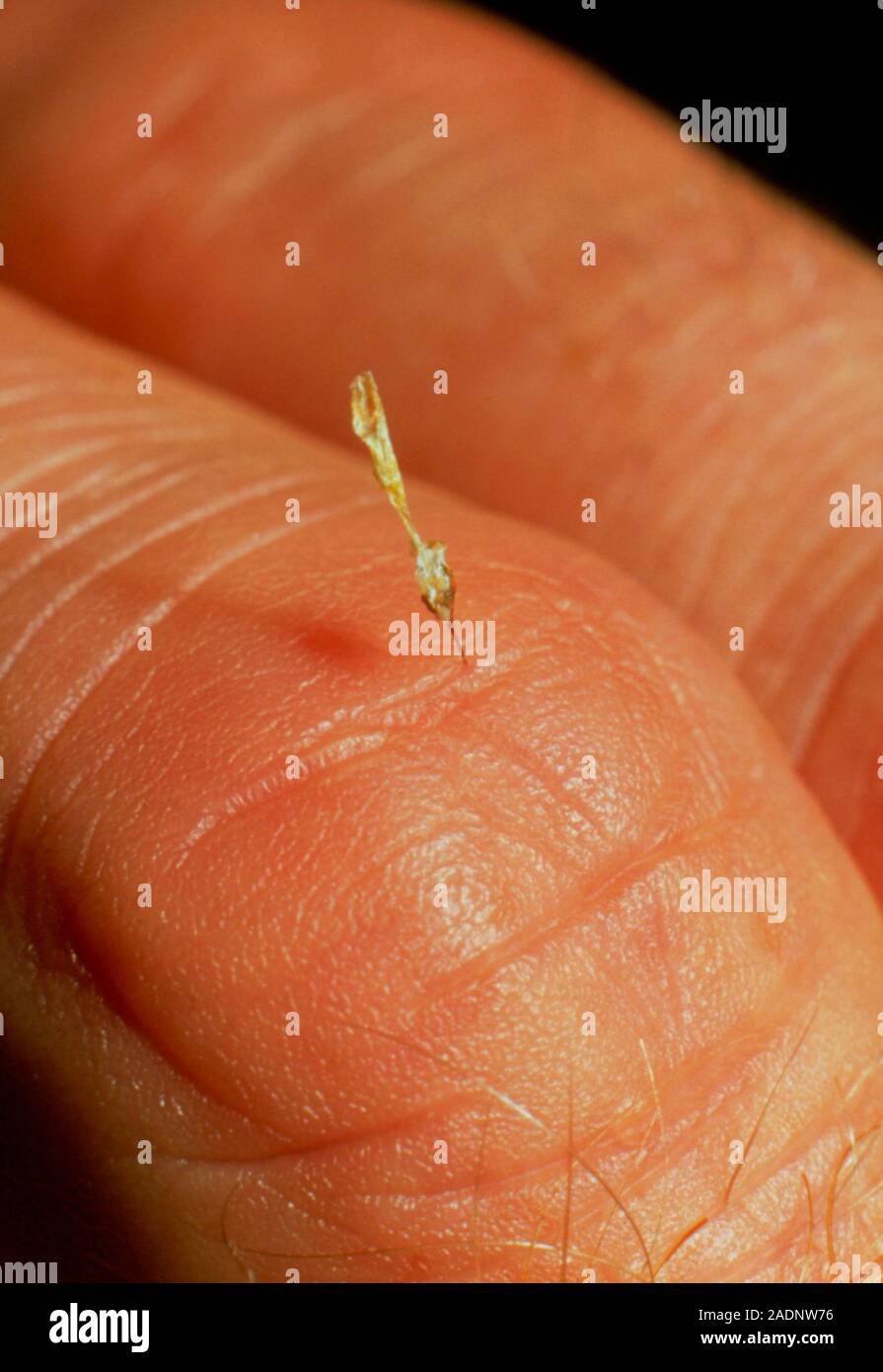 Bee sting. View of a honeybee sting embedded in the skin of a human finger. At centre, the sting ...