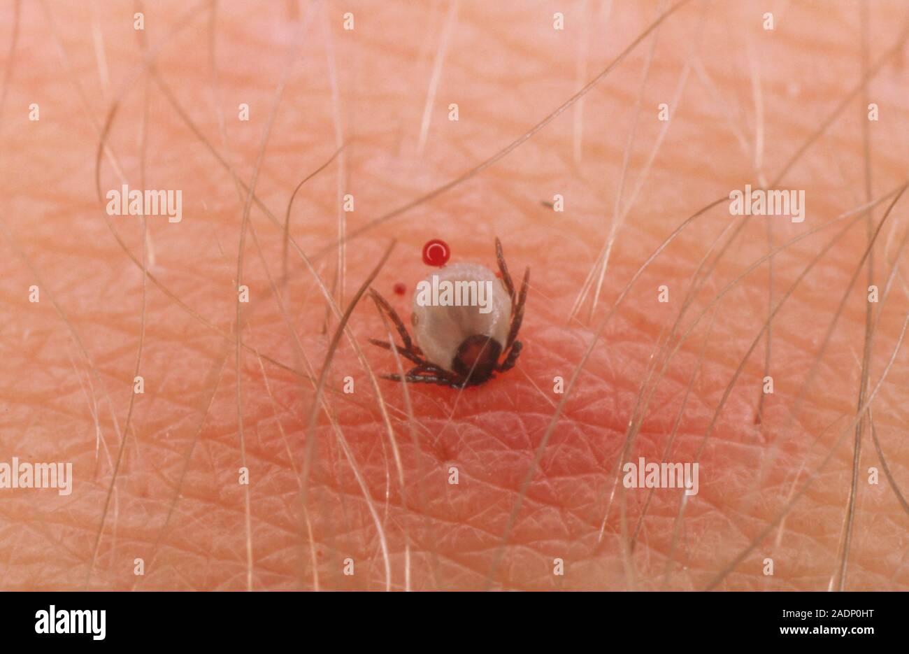 A tick feeding on a human leg. Ticks are arachnids which parasitise ...