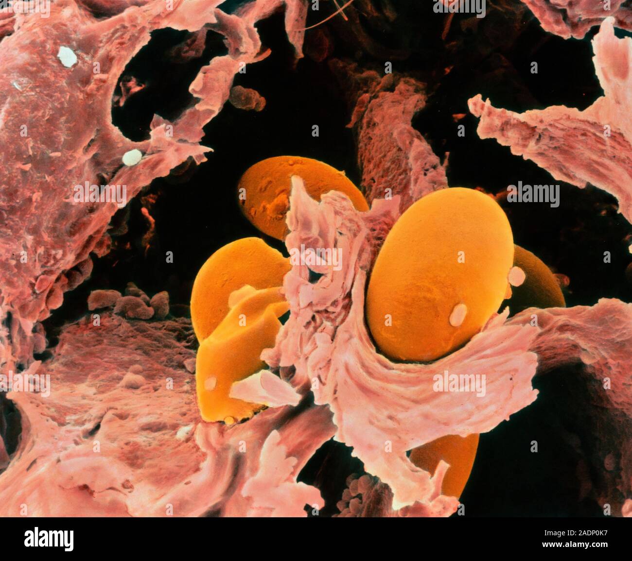 Scabies eggs in skin. Coloured scanning electron micrograph of eggs of ...